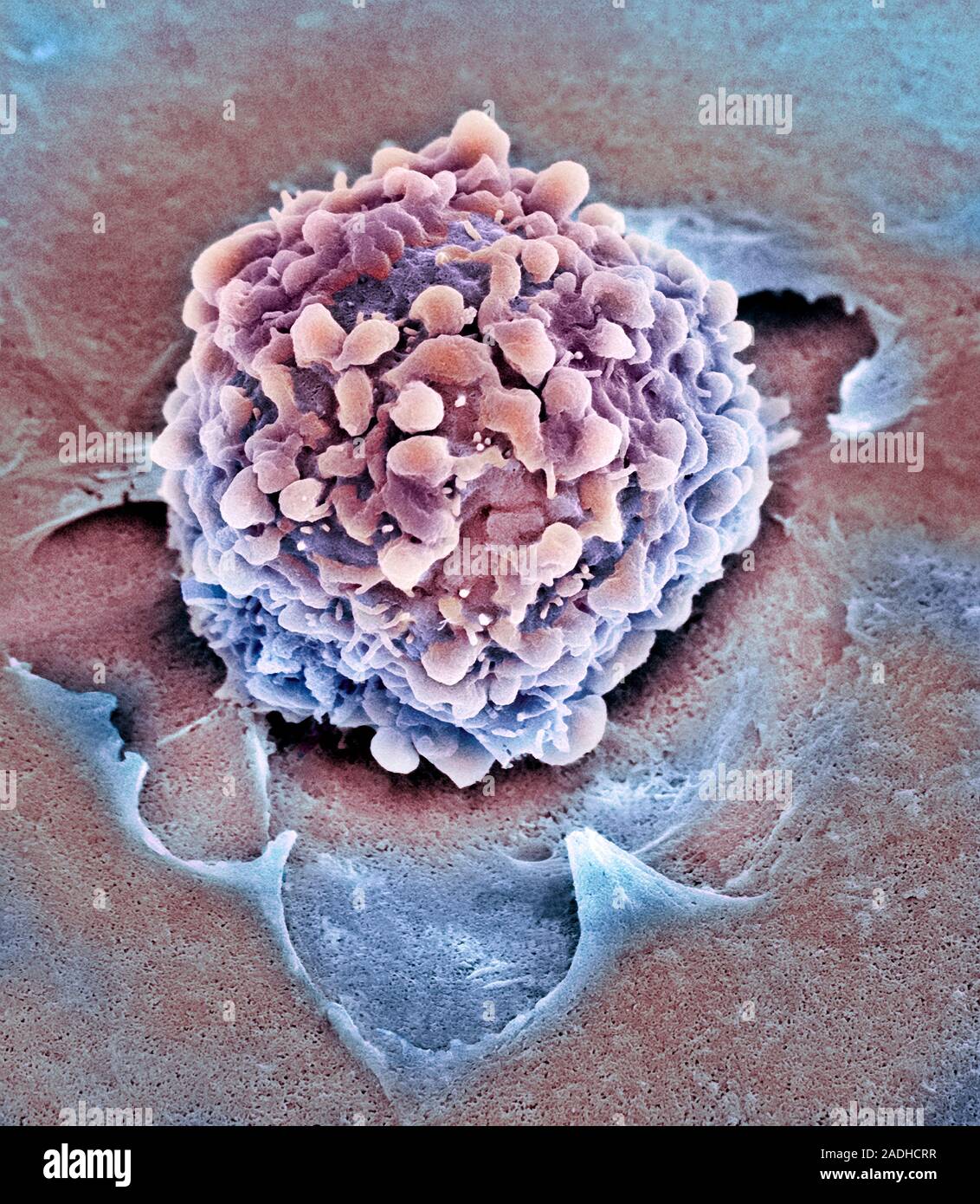 Rectal cancer cell. Coloured scanning electron micrograph (SEM) of a ...