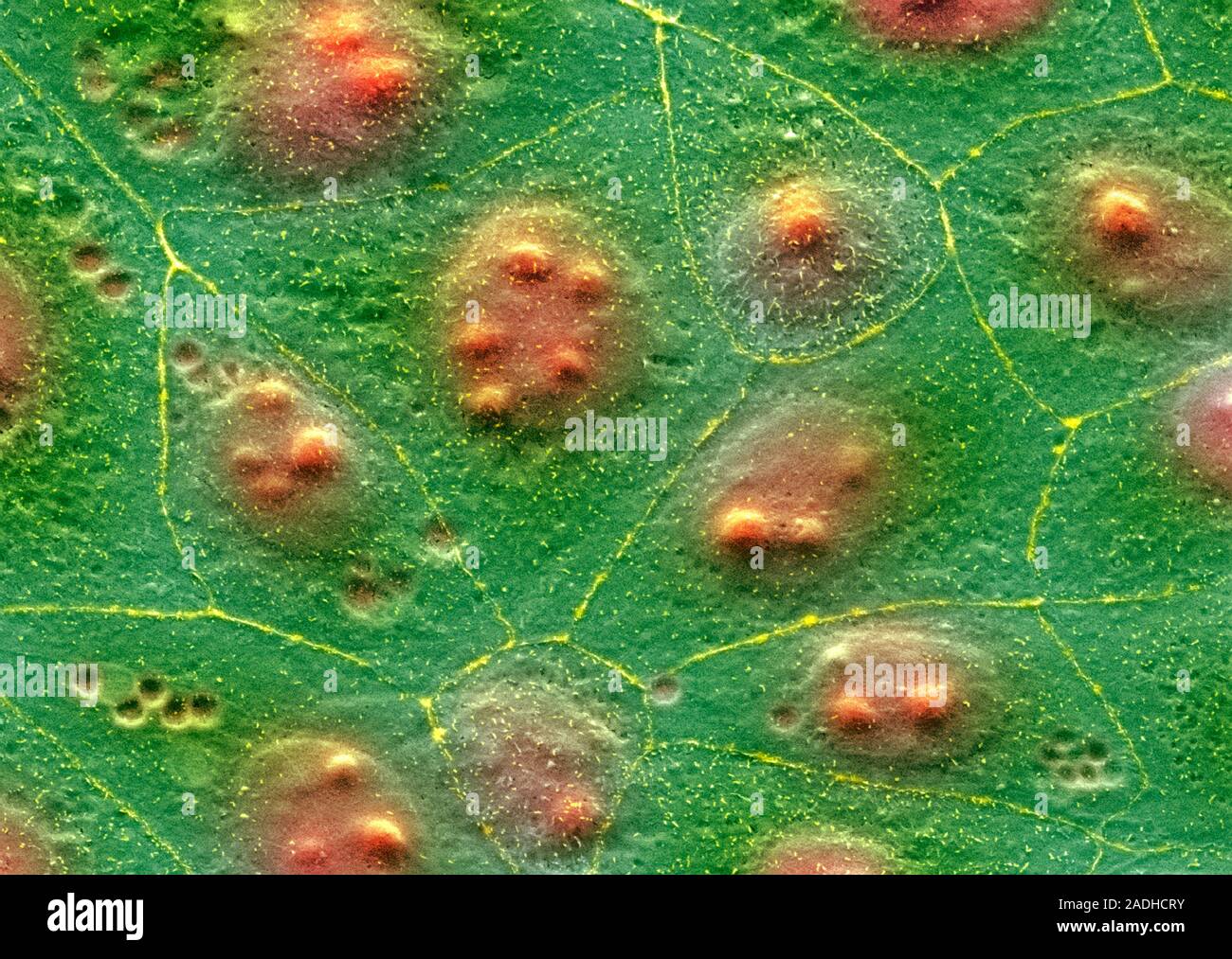 Rectal cancer cells. Coloured scanning electron micrograph (SEM) of ...