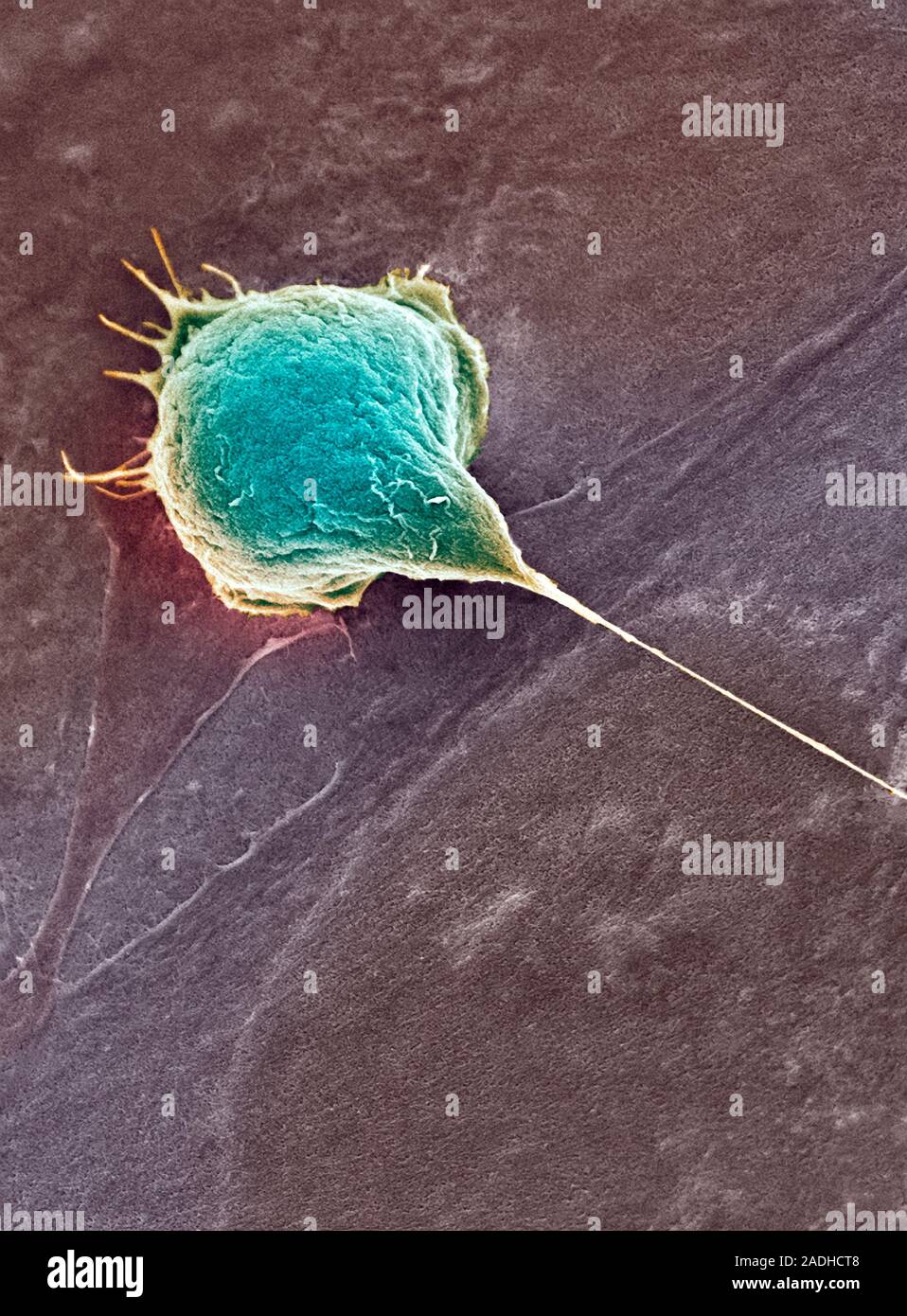 Bladder cancer cell. Coloured scanning electron micrograph (SEM) of a ...