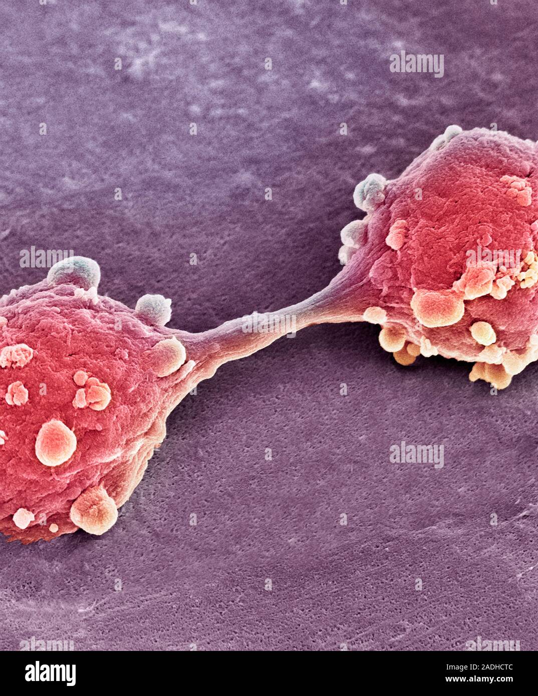 Bladder cancer cells dividing. Coloured scanning electron micrograph ...