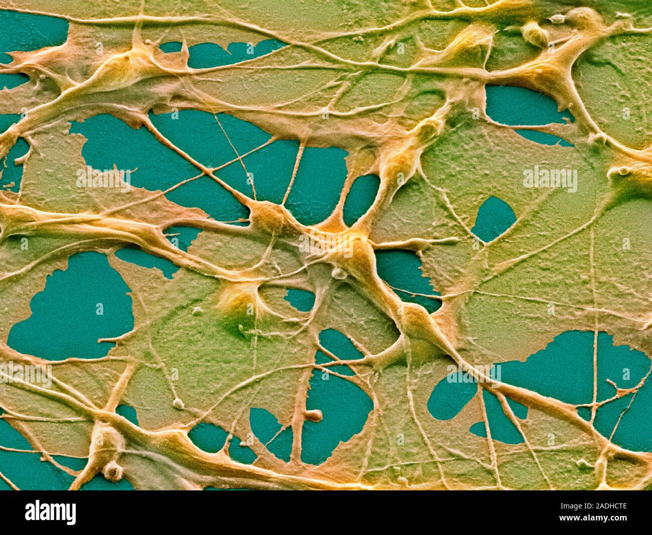 Teratoma cancer cells. Coloured scanning electron micrograph (SEM) of ...