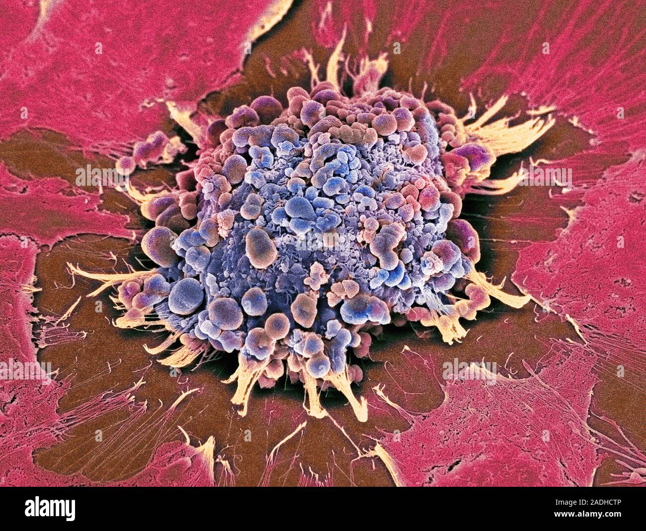 Cancer cell apoptosis. Coloured scanning electron micrograph (SEM) of a ...