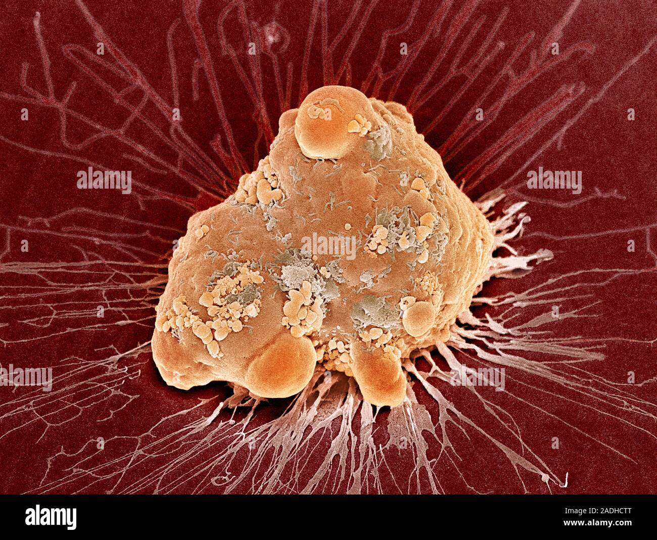 Cancer cell apoptosis. Coloured scanning electron micrograph (SEM) of a ...