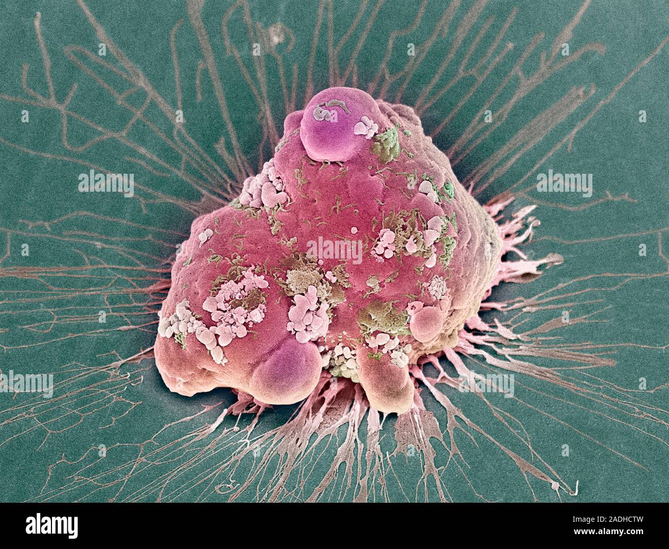 Cancer cell apoptosis. Coloured scanning electron micrograph (SEM) of a ...