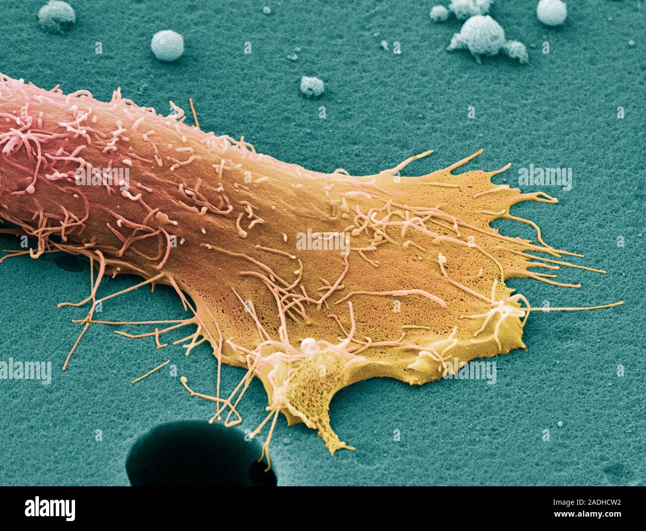 Prostate cancer cell. Coloured scanning electron (SEM) micrograph of a ...