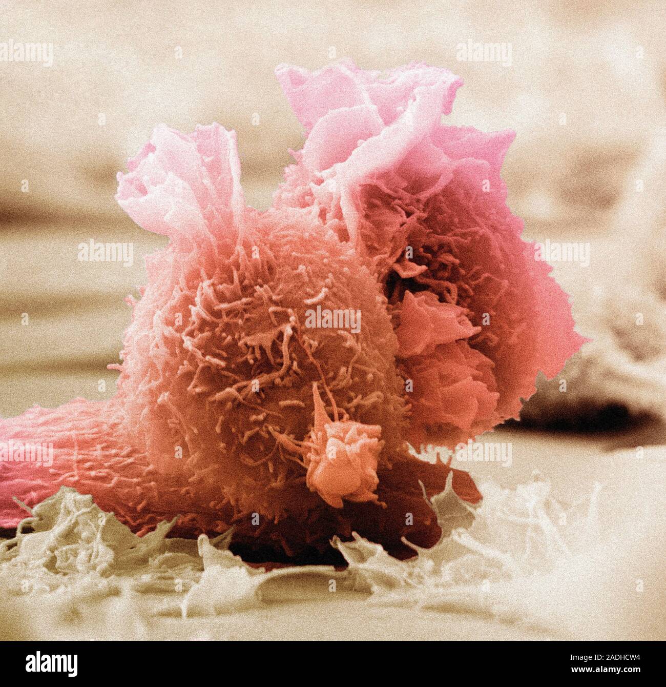 Sarcoma cells, coloured scanning electron micrograph (SEM). Sarcomas ...