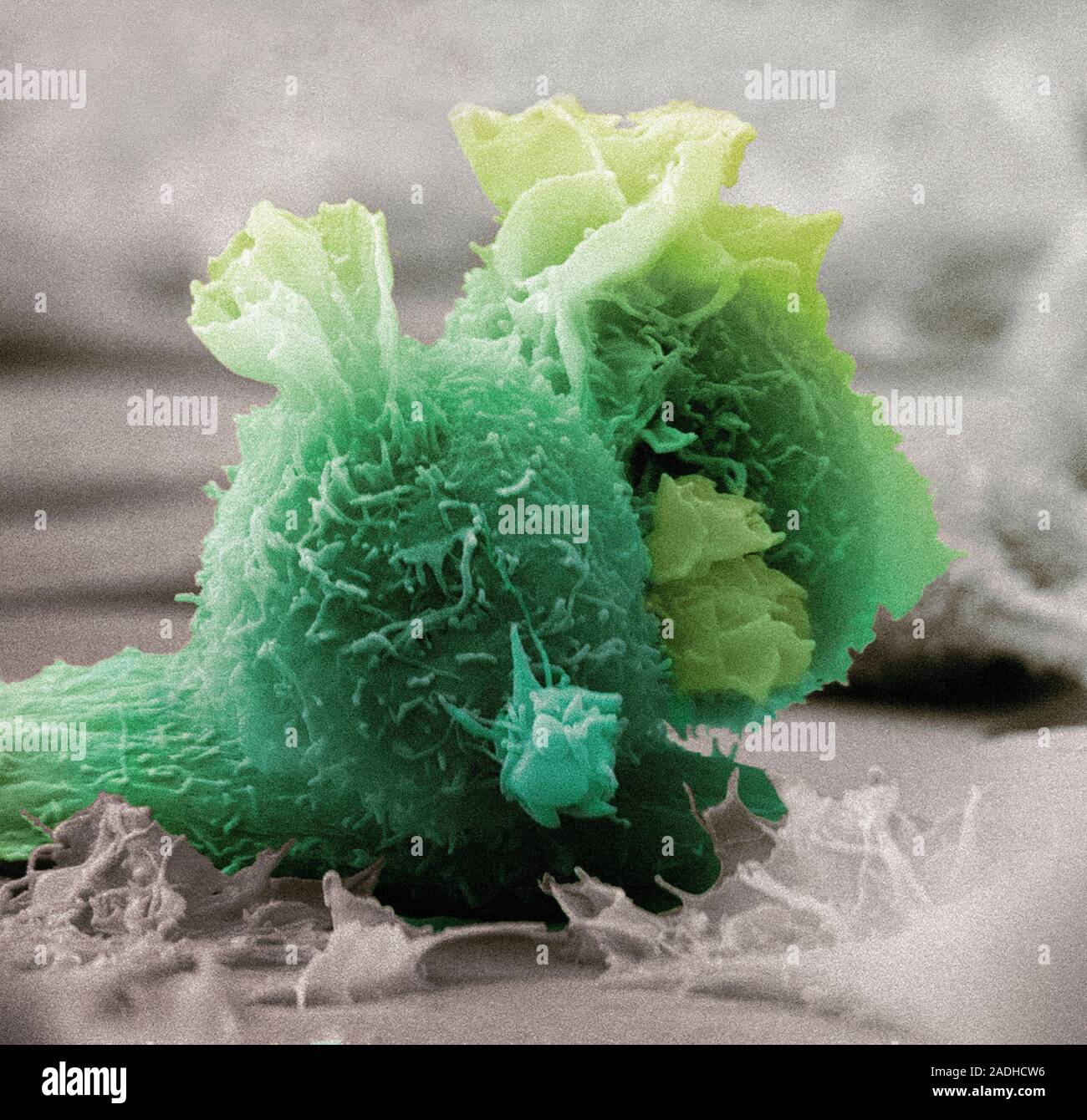 Sarcoma cells, coloured scanning electron micrograph (SEM). Sarcomas ...