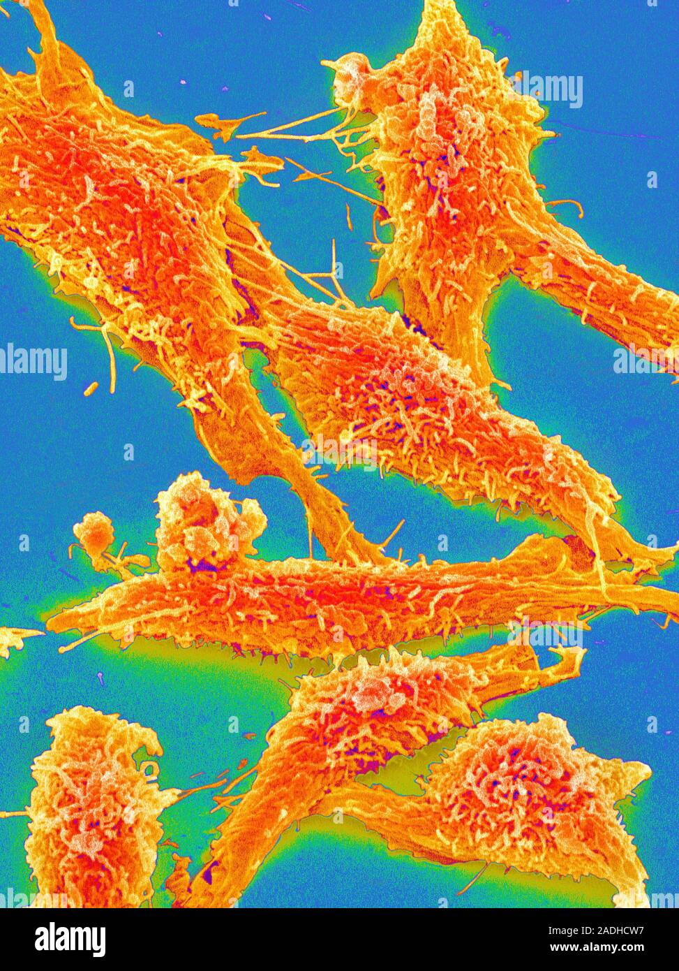 Colon cancer. Coloured scanning electron micrograph (SEM) of cancer ...