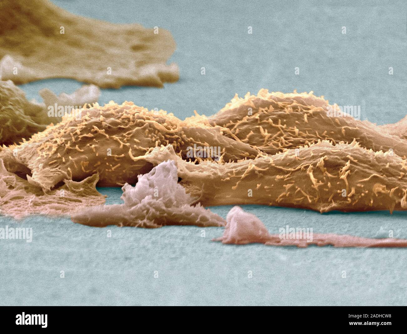 Sarcoma cells. Coloured scanning electron micrograph (SEM) of sarcoma ...