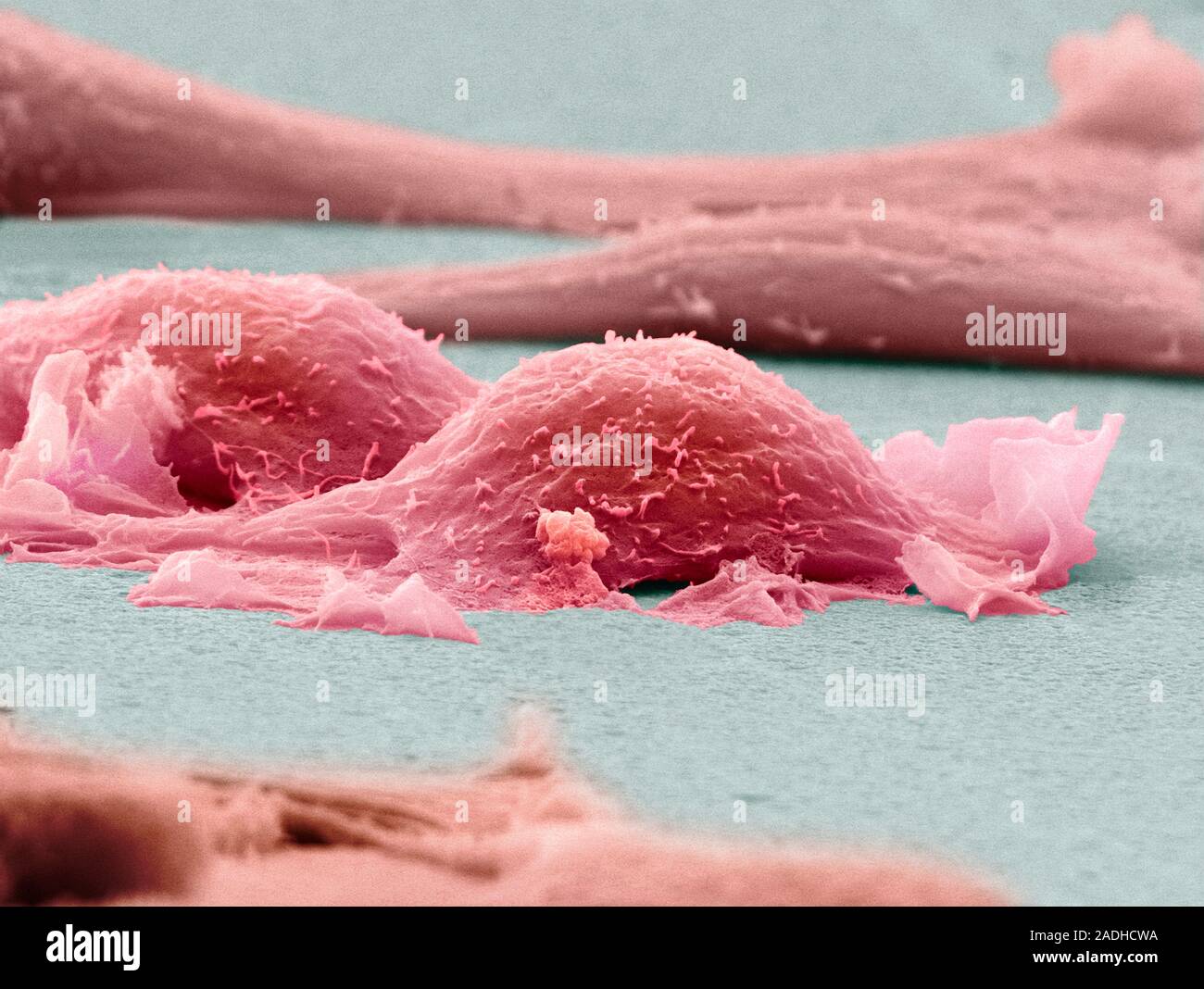 Sarcoma cells. Scanning electron micrograph (SEM) of sarcoma cells in ...