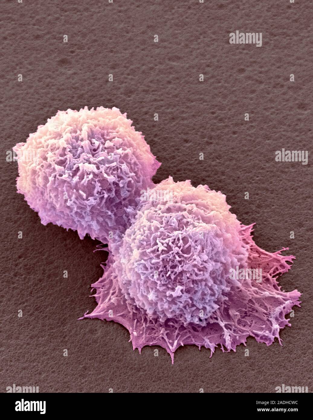 Sarcoma cells. Scanning electron micrograph (SEM) of sarcoma cells in ...