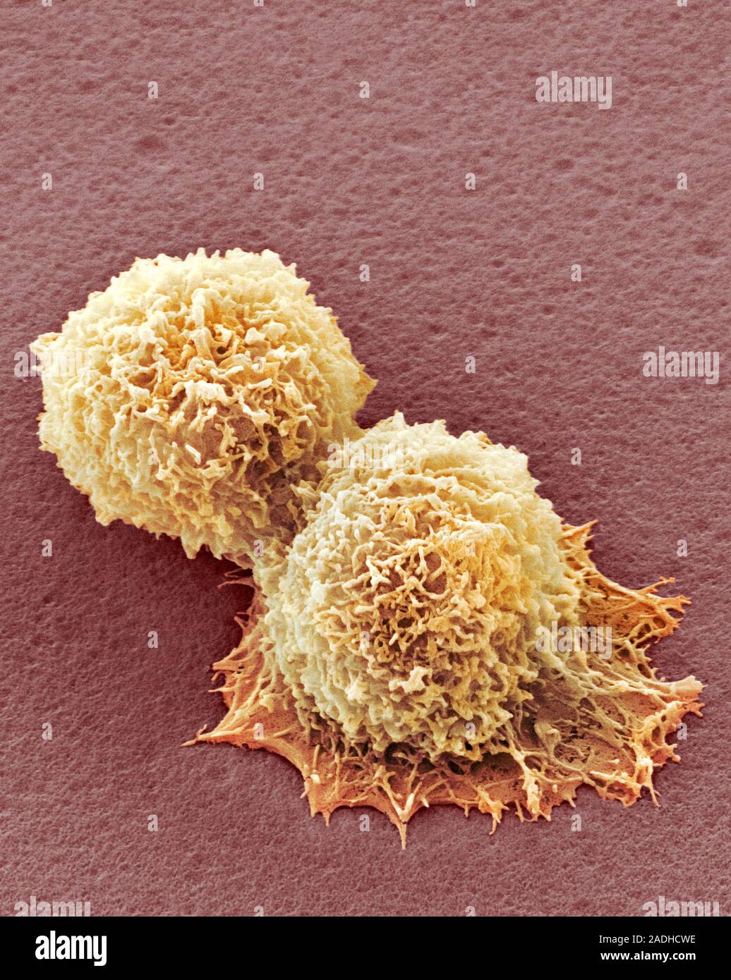 Sarcoma cells. Scanning electron micrograph (SEM) of sarcoma cells in ...