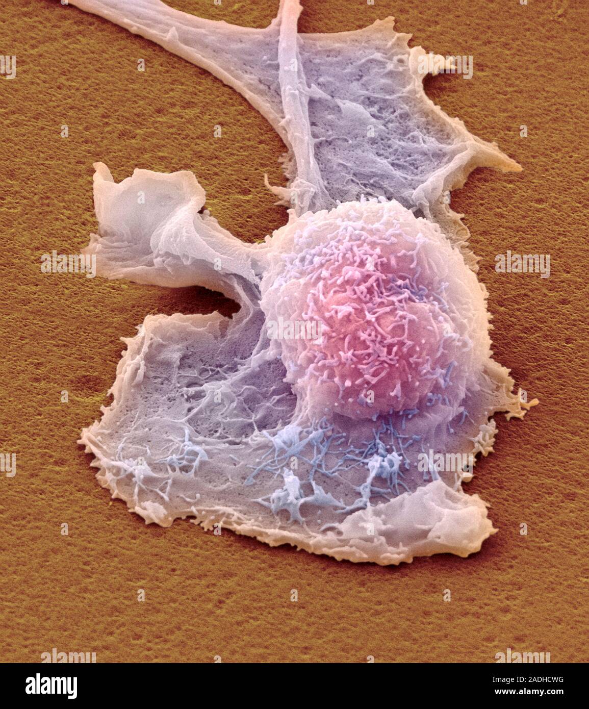 Sarcoma cell. Scanning electron micrograph (SEM) of a sarcoma cell in ...