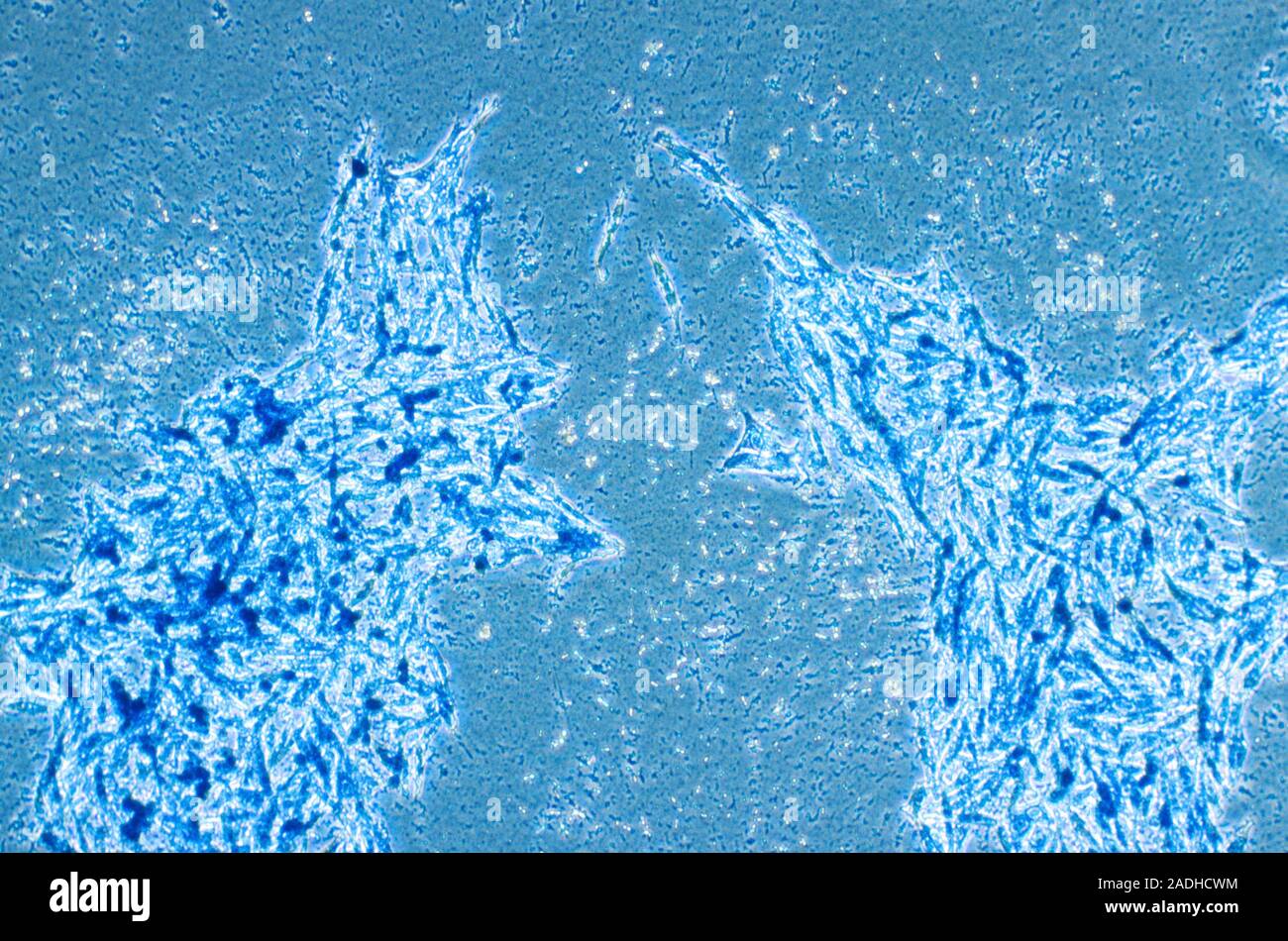 Skin cancer cells. Light micrograph of colonies of melanoma cancer ...