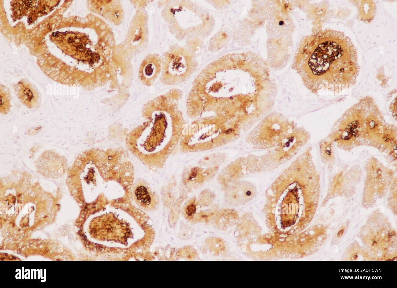 Colon cancer. Light micrograph of a section through the colon (large ...