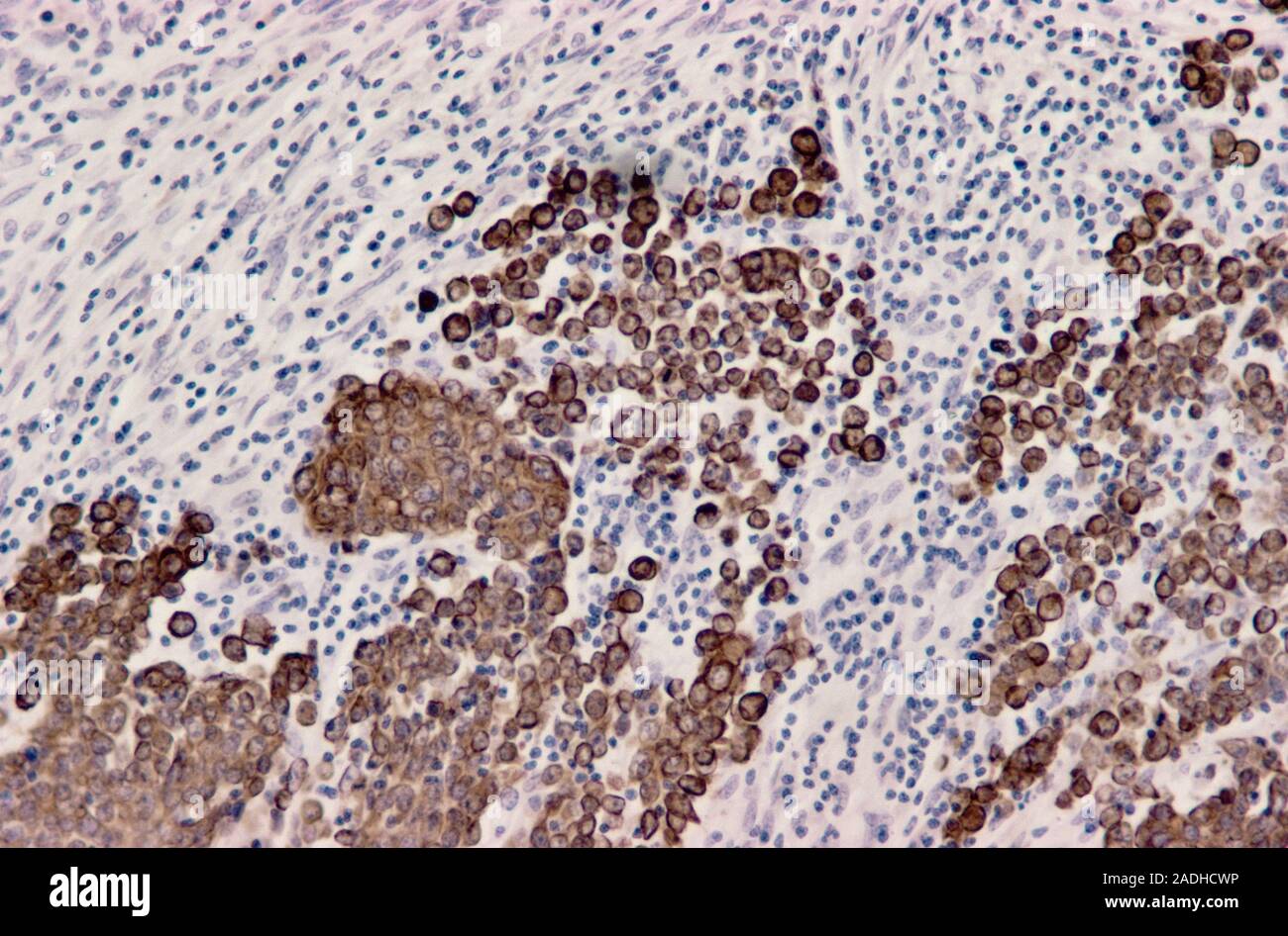 Lymph Node Cancer Light Micrograph Of A Section Through Lymph Node
