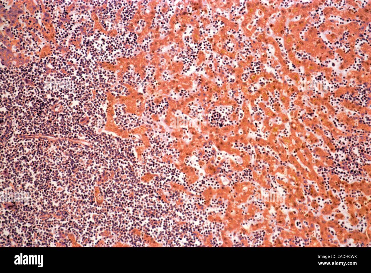 Leukaemia blood cells. Light micrograph of blood cells (mainly B cells ...