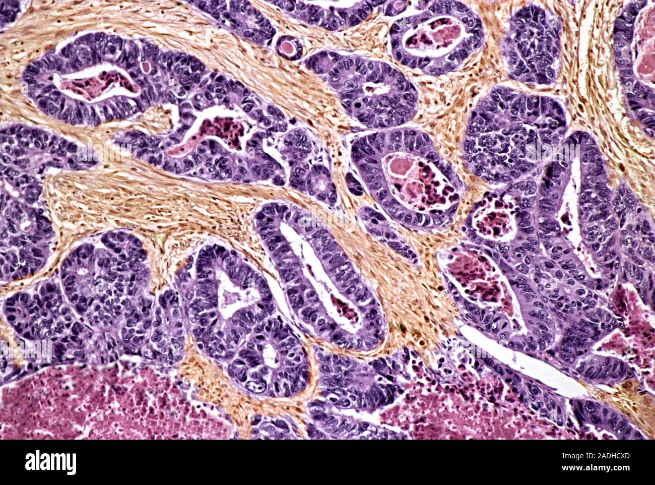 Stomach cancer. Light micrograph of a section through an adenocarcinoma ...