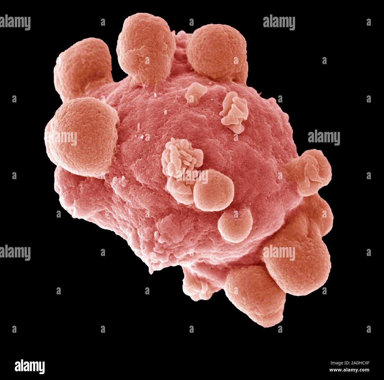 Leukaemia cell, coloured scanning electron micrograph (SEM). Leukaemia ...