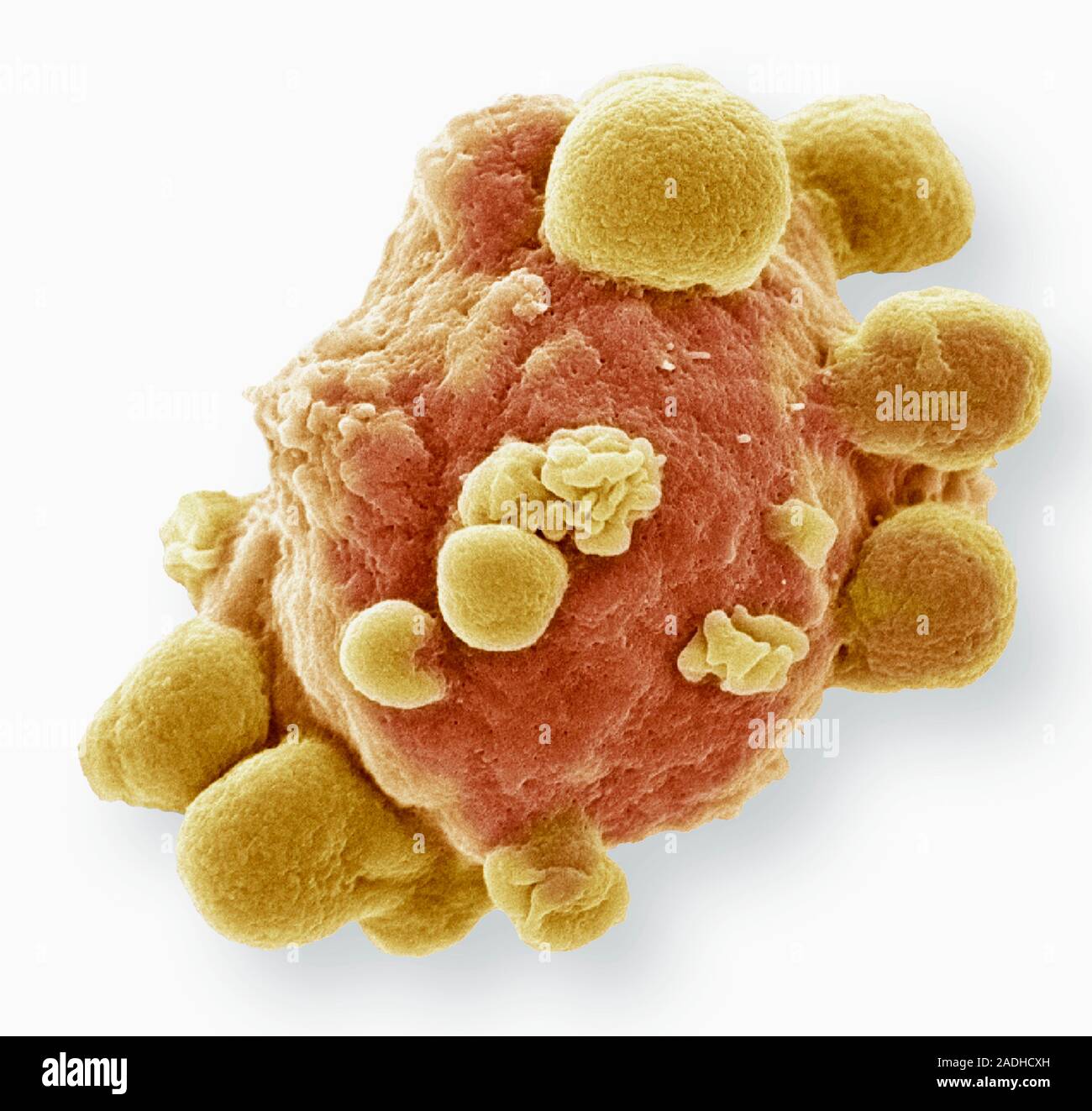 Leukaemia cell, coloured scanning electron micrograph (SEM). Leukaemia ...