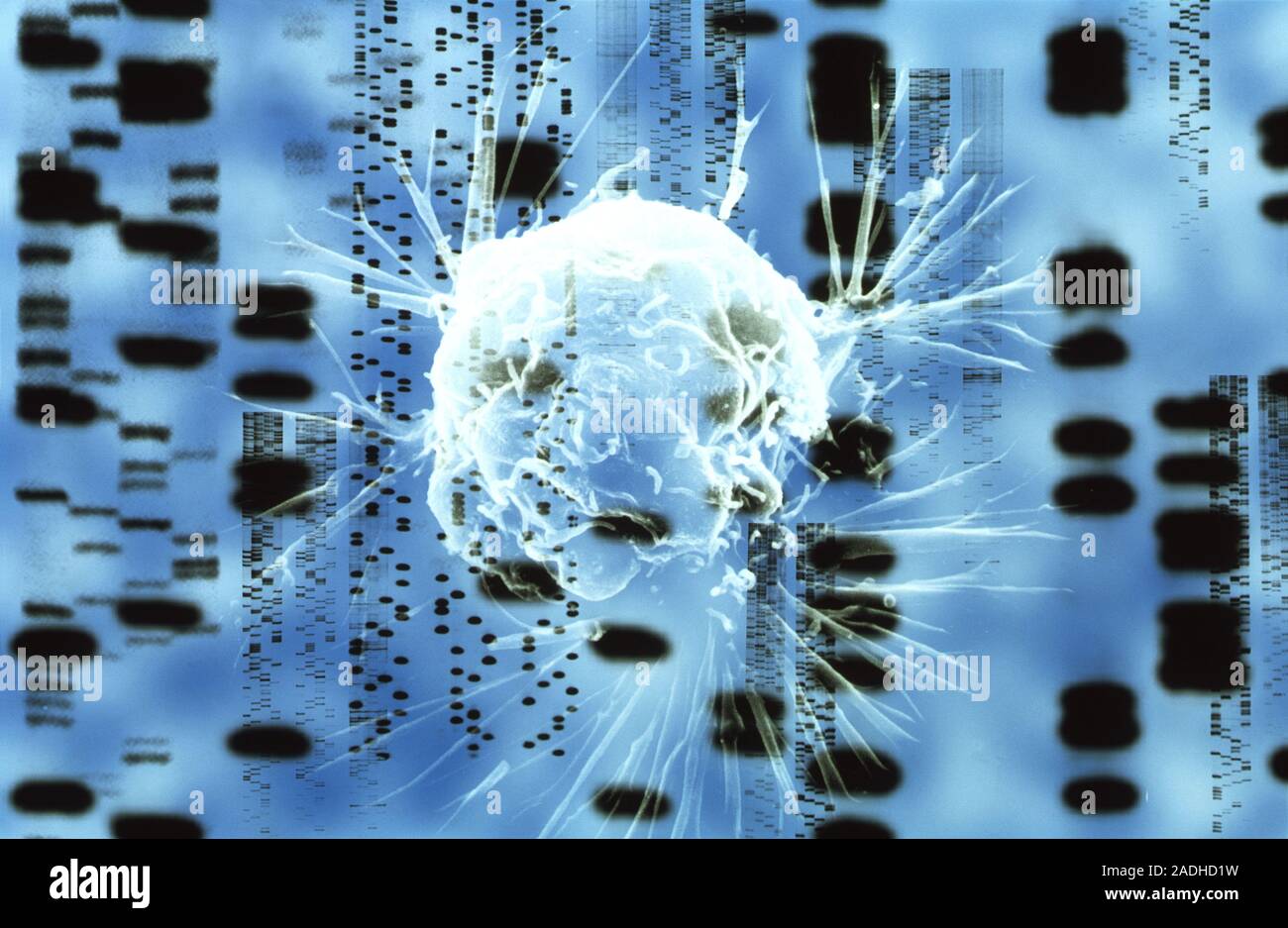 Cancer research. Coloured scanning electron micrograph (SEM) of a ...