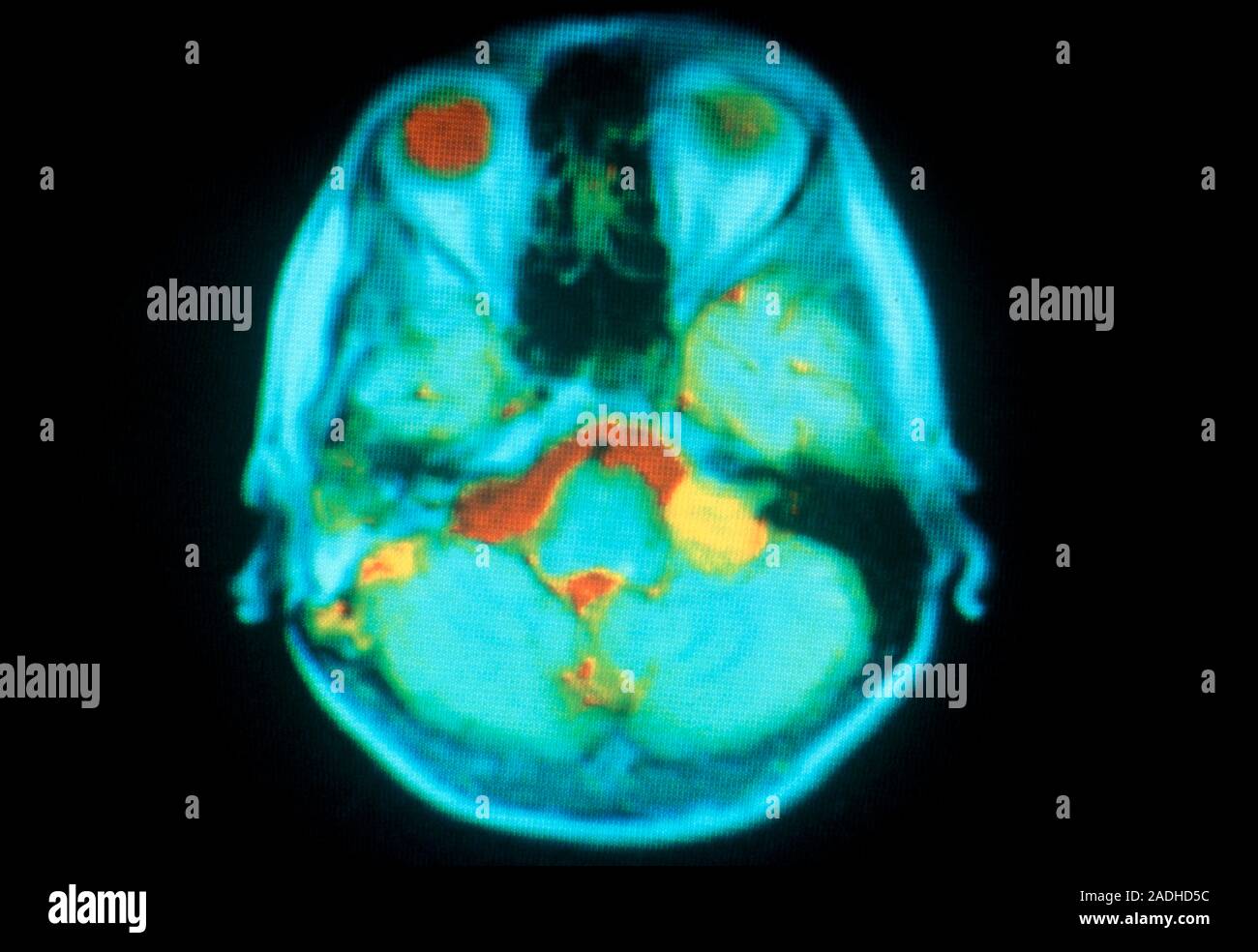 Nuclear magnetic resonance (NMR) image of the brain of person suffering ...
