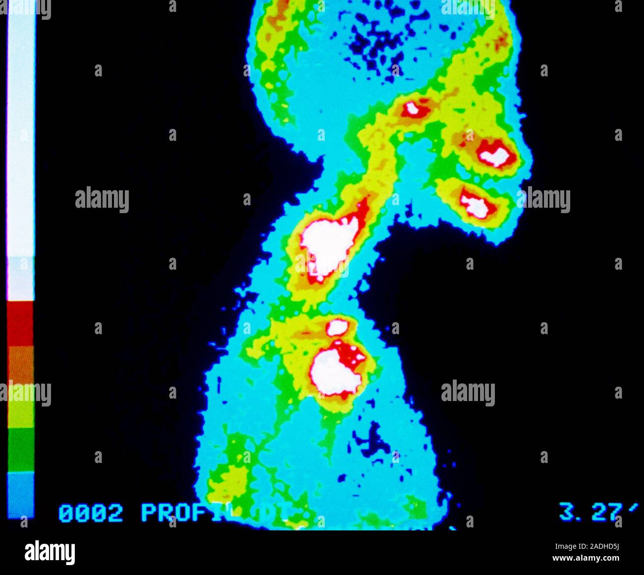 False colour bone scintigram (gamma camera scan) of a median (profile ...