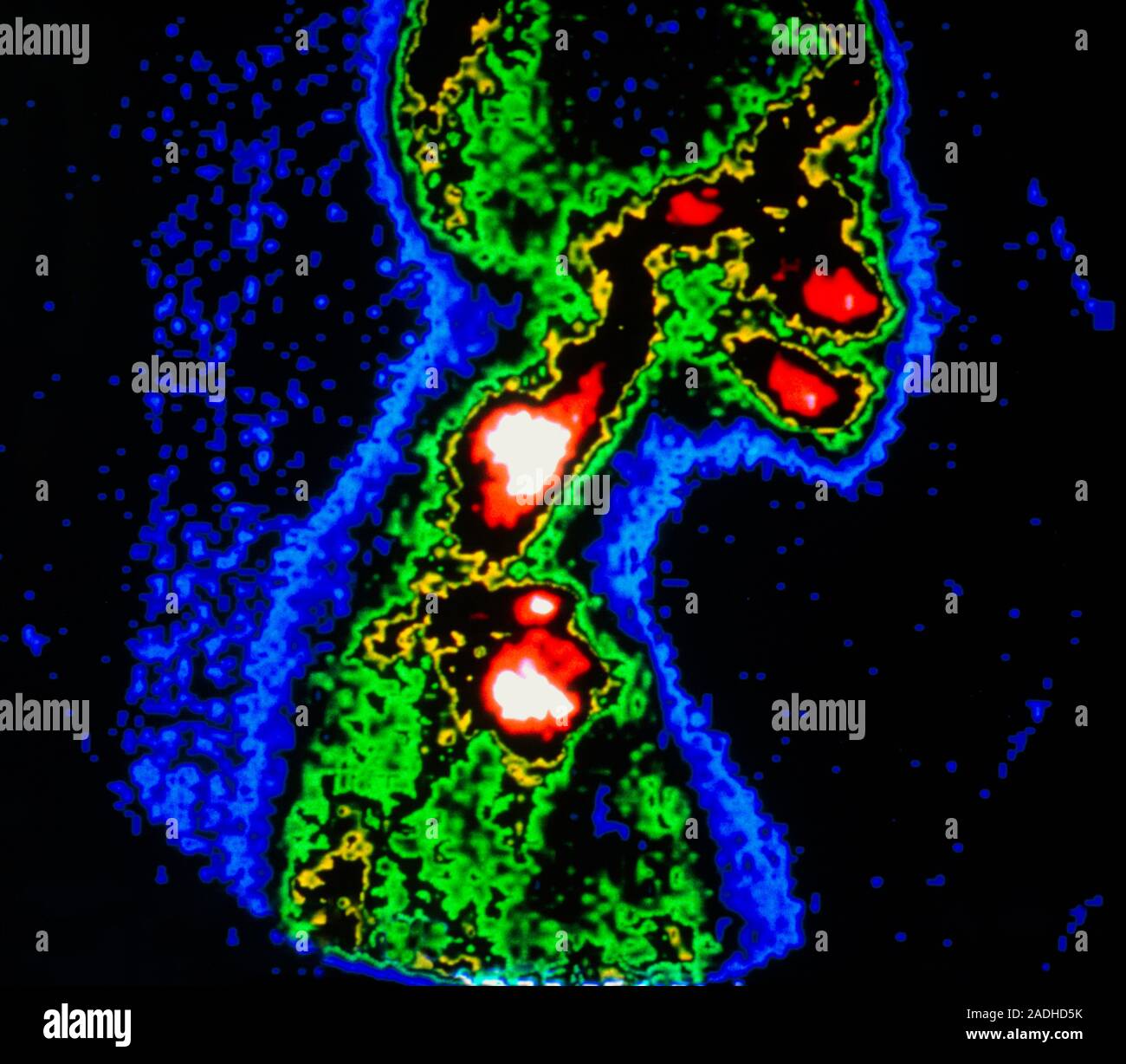 False colour bone scintigram (gamma camera scan) of a median (profile ...