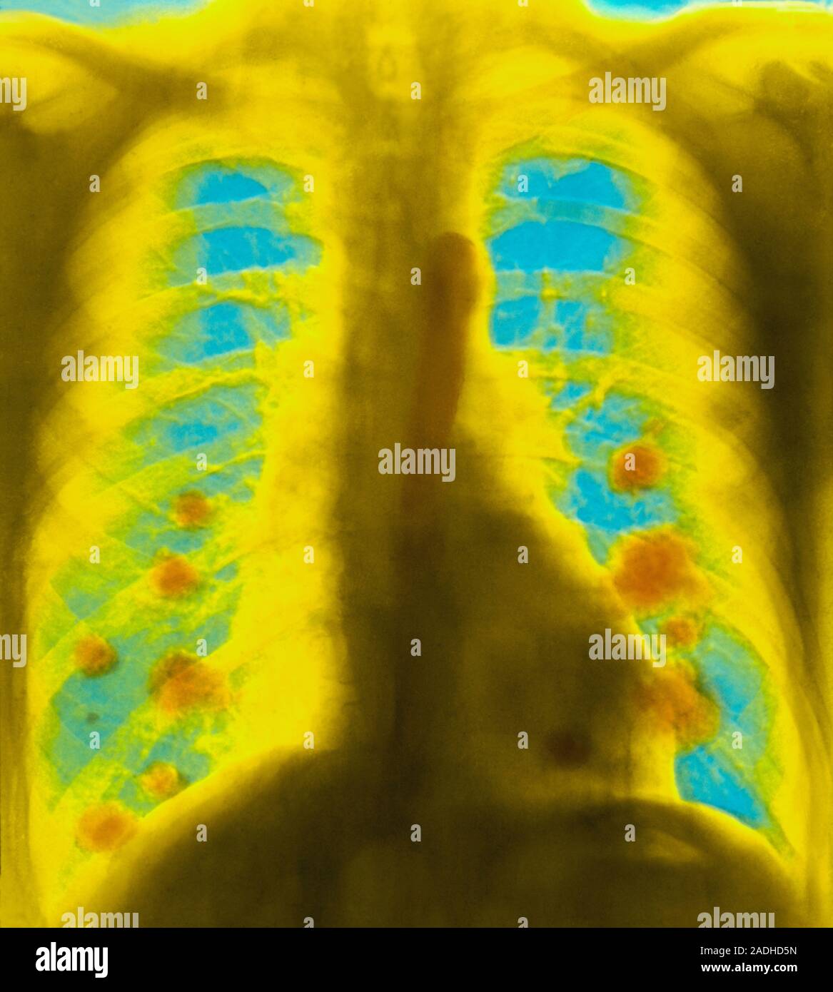 False-colour chest X-ray (front view) showing evidence of cancer in ...
