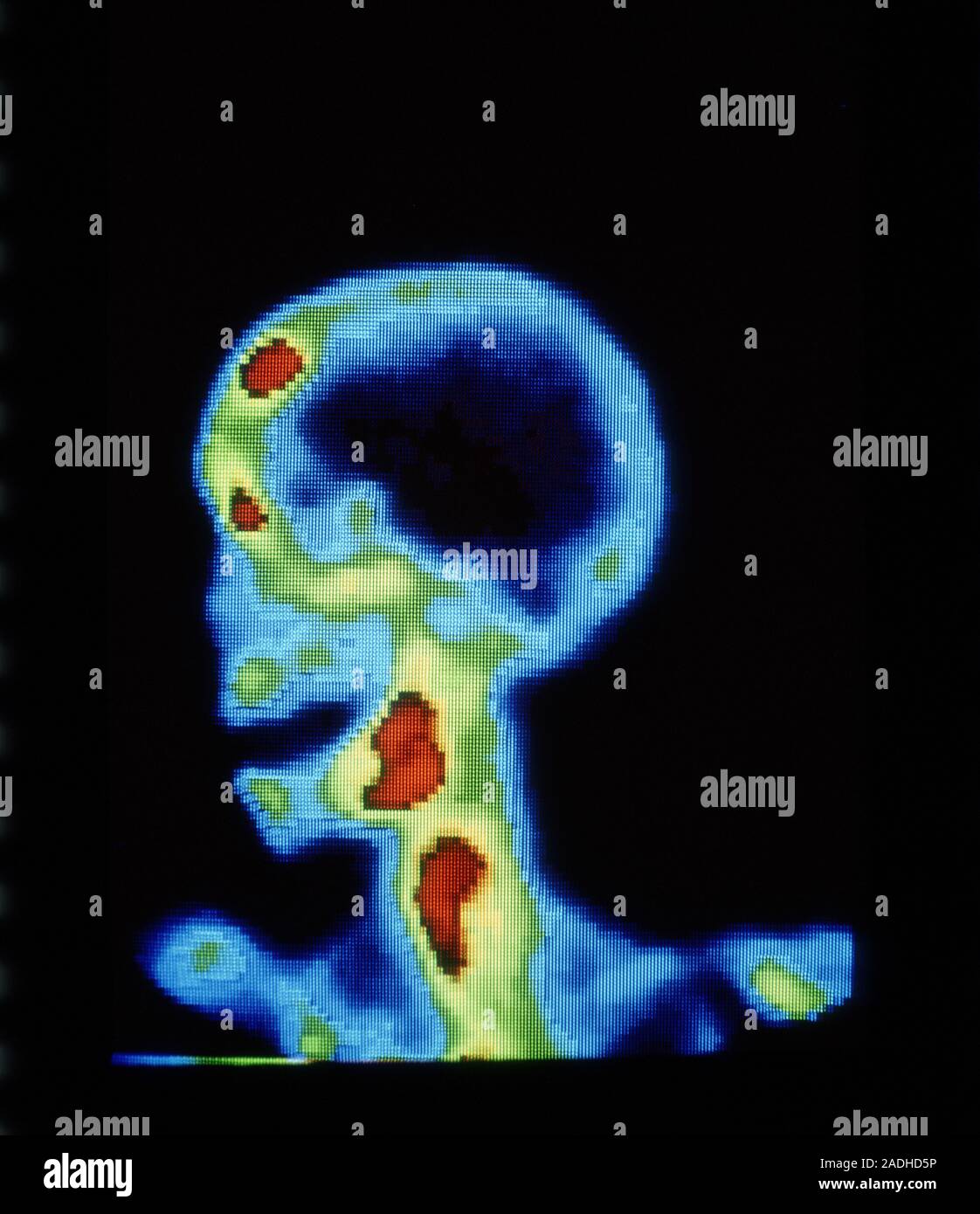 Gamma camera scan of the skull of a person suffering from secondary ...