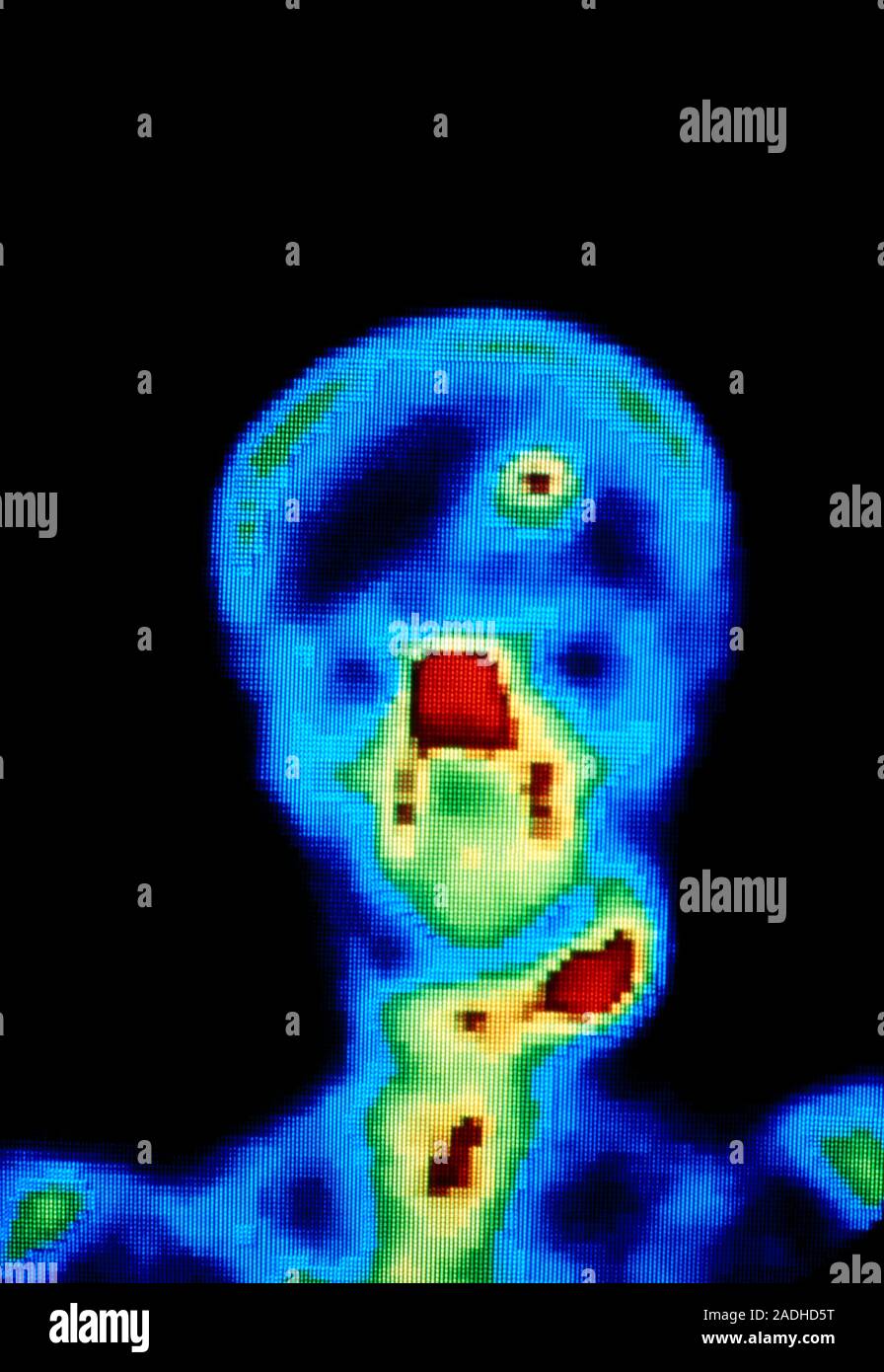 Gamma camera scan of the skull of a person suffering from secondary ...