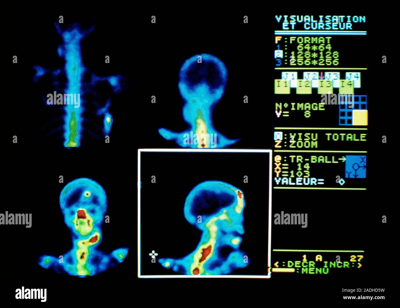 Gamma camera scans of the skull & spine of a person suffering from ...