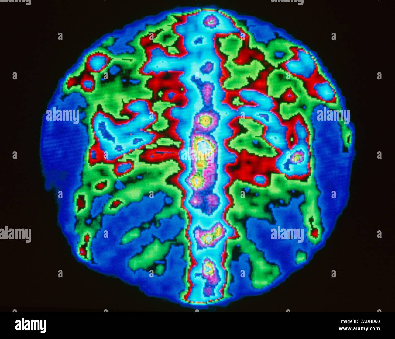 False-colour scintigram (bone scan) of the human spine and ribs ...