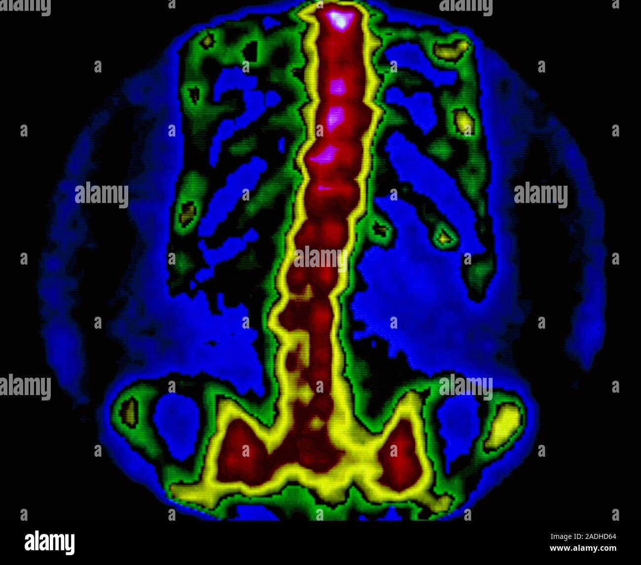 False-colour scintigram (bone scan) of the human spine and ribs ...