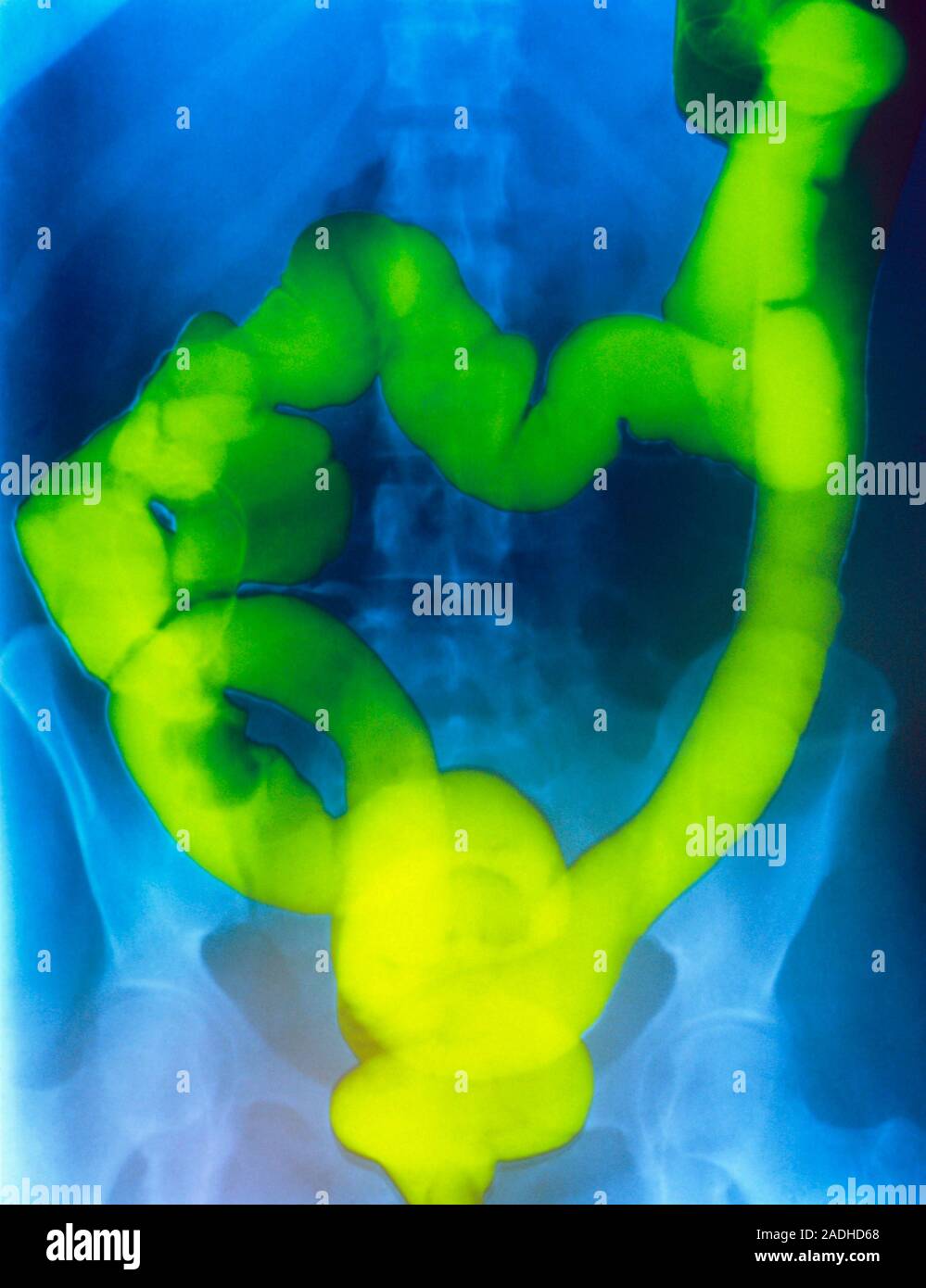 False-colour barium enema X-ray of the human abdomen showing a cancer ...