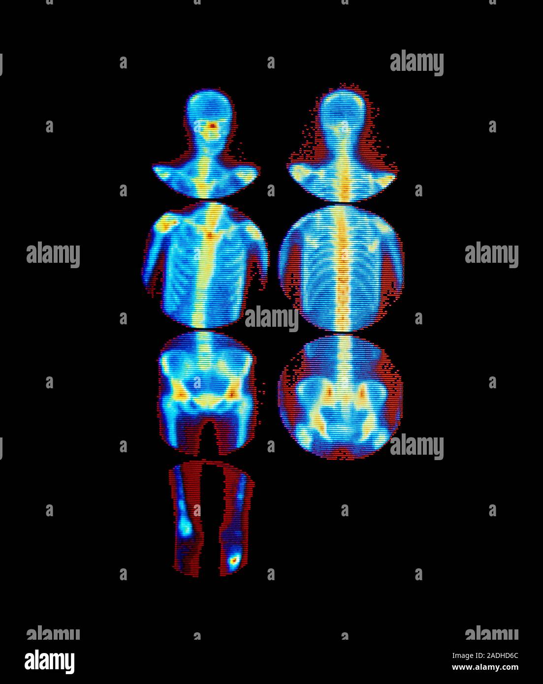 Secondary (metastatic) bone cancer: false-colour gamma camera scans of ...