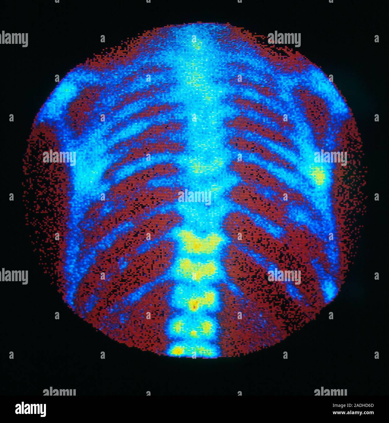 Secondary (metastatic) bone cancer: false-colour gamma camera scan ...