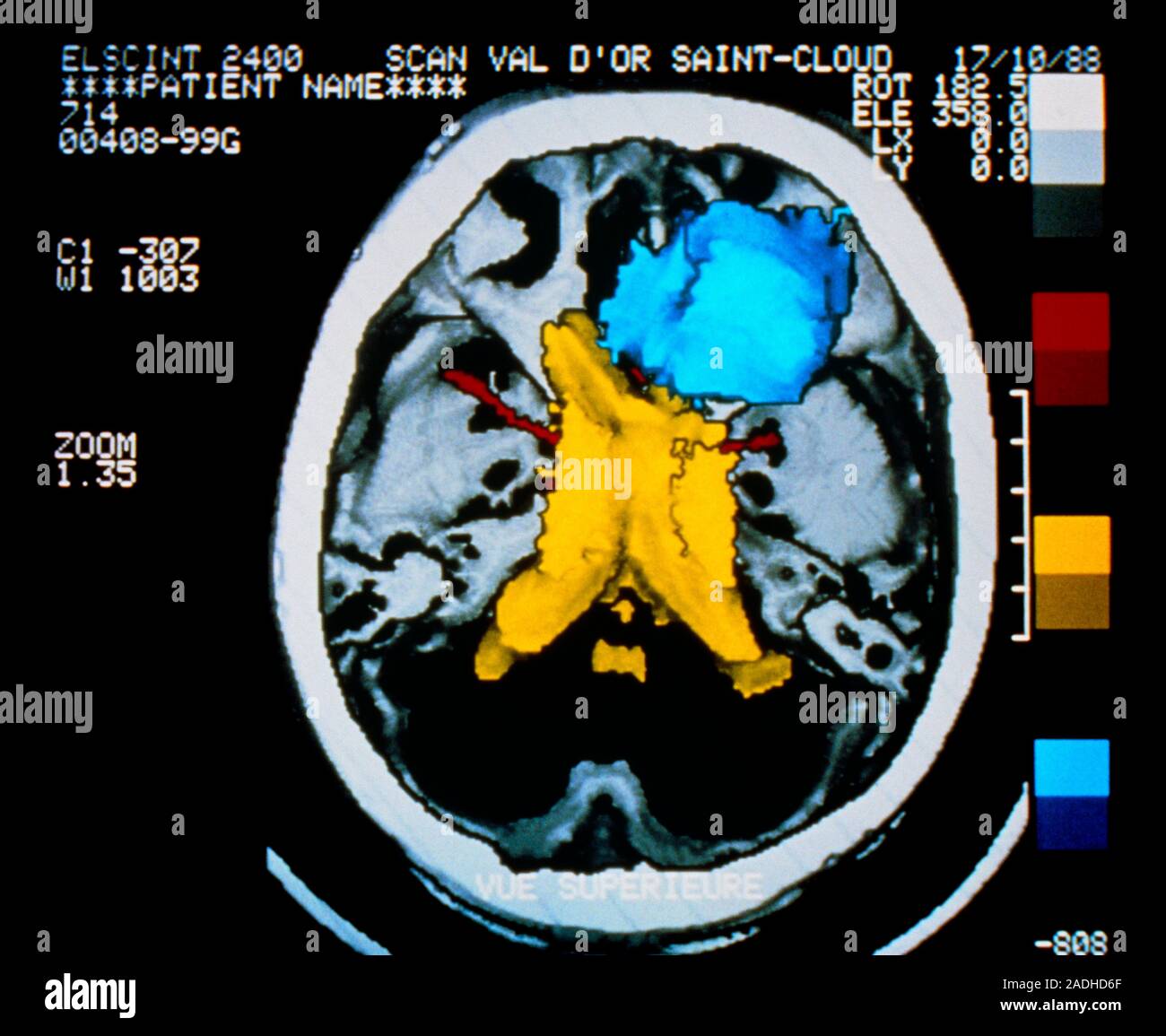 False-colour 3-D CT (computed tomography) brain scan revealing a ...