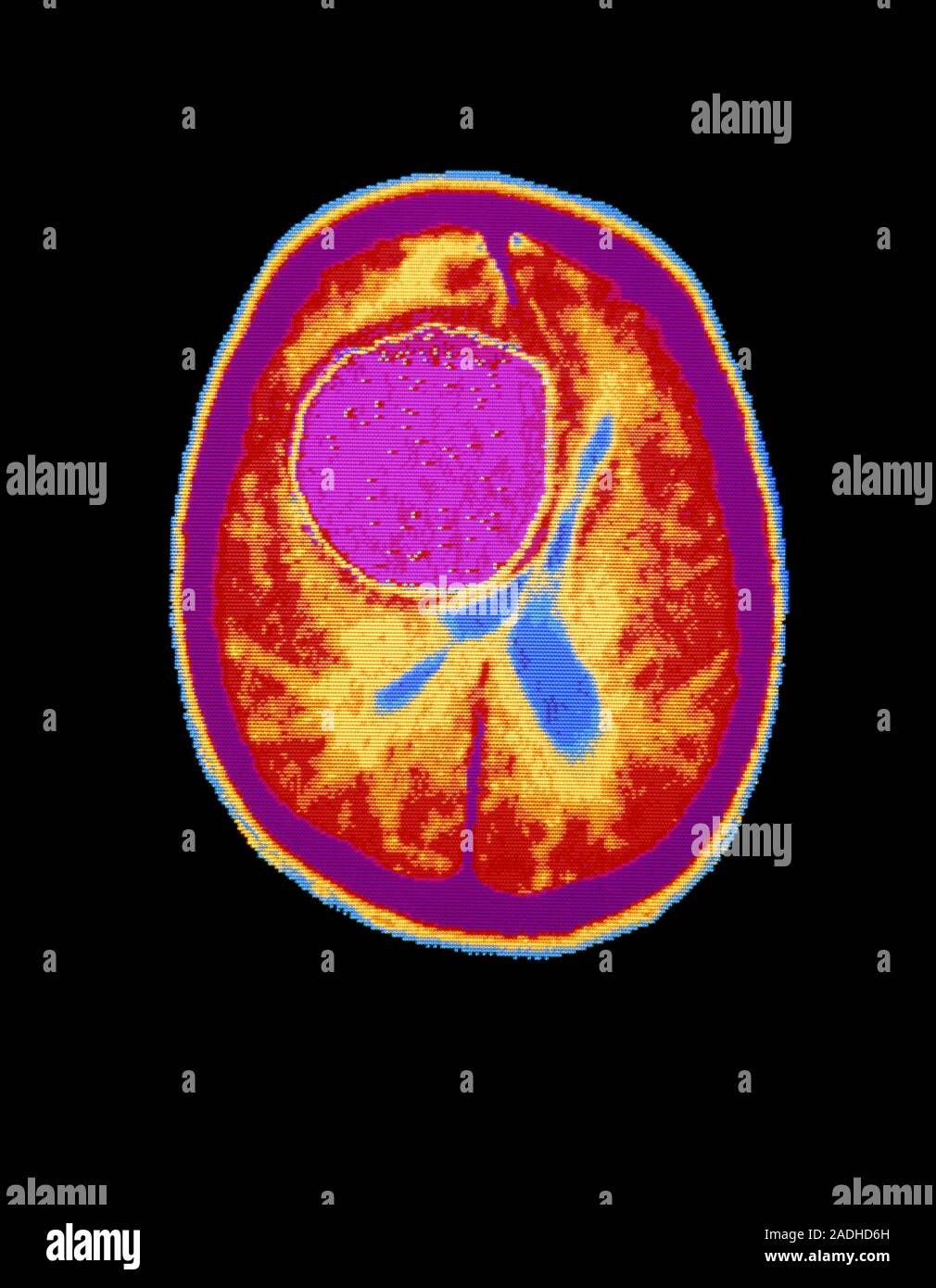 False-colour computed tomography (CT) brain scan showing a large ... False-colour computed tomography (CT) brain scan showing a large ...