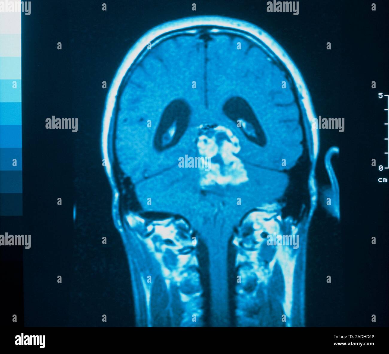 Cerebellar glioma (brain tumour). Magnetic resonance image (MRI) of a coronal section of the ...