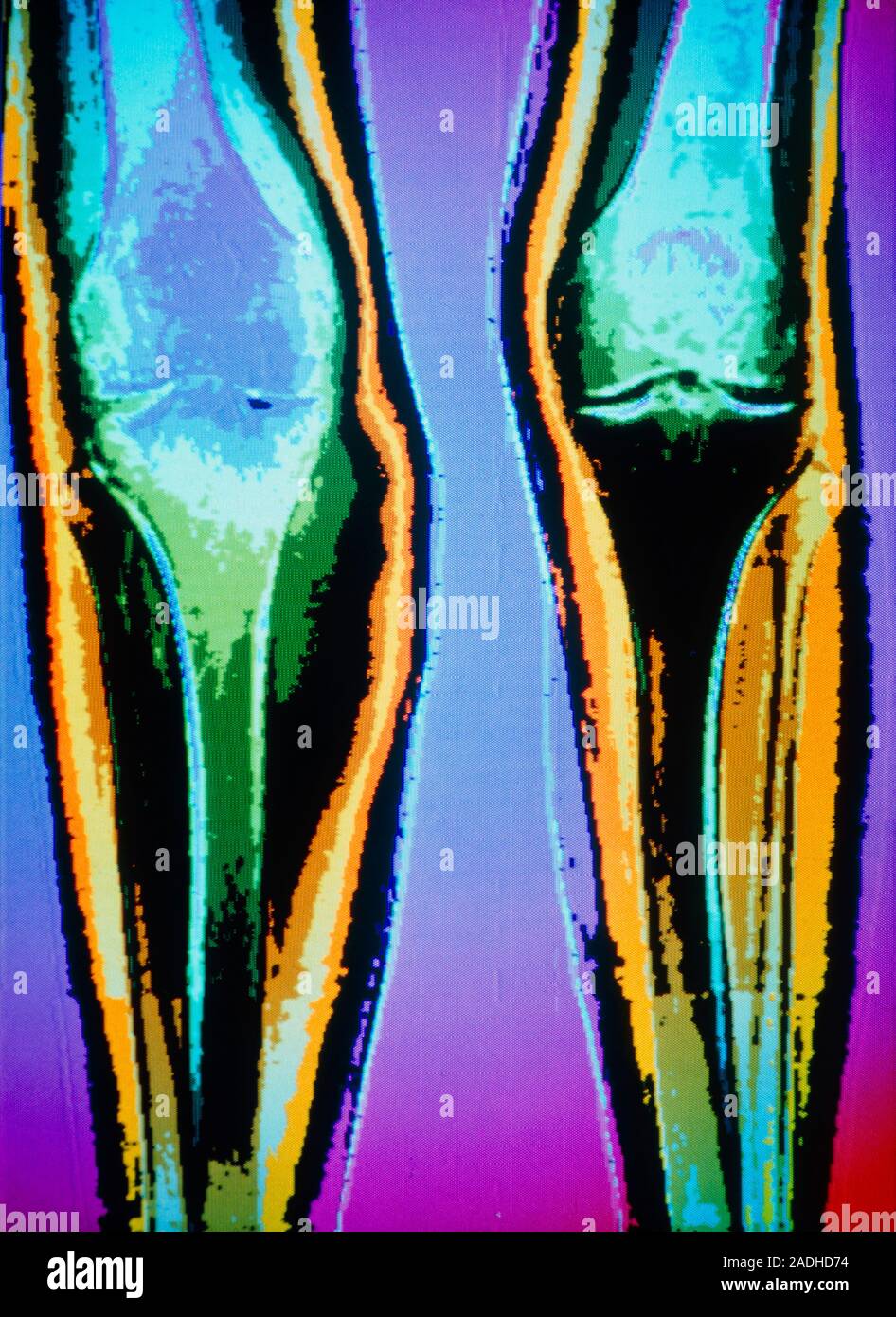 Osteosarcoma. False-colour computed tomography (CT) scan of the knee ...
