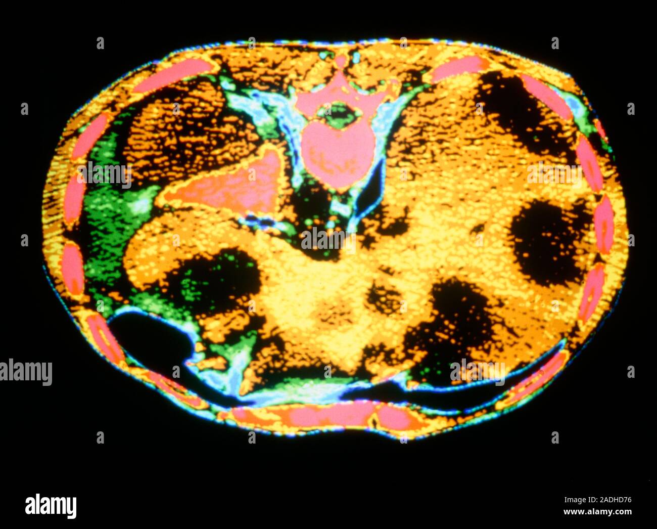 Cancer of liver. Coloured computed tomography (CT) scan showing metastatic growths on the liver ...