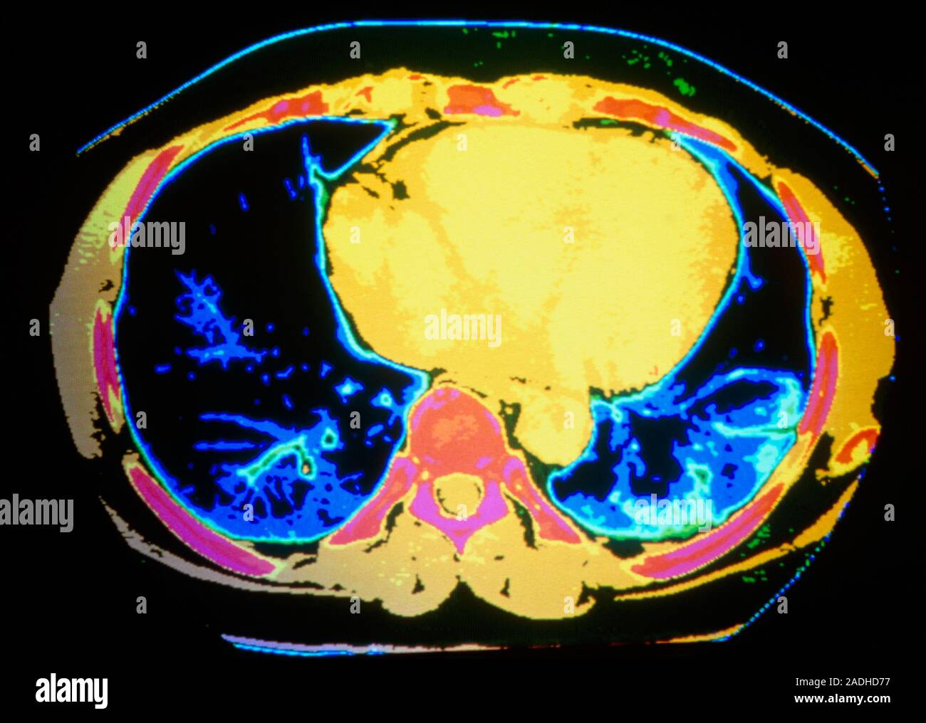 Cancer of lung. Coloured computed tomography (CT) scan showing the left lung (right of image ...