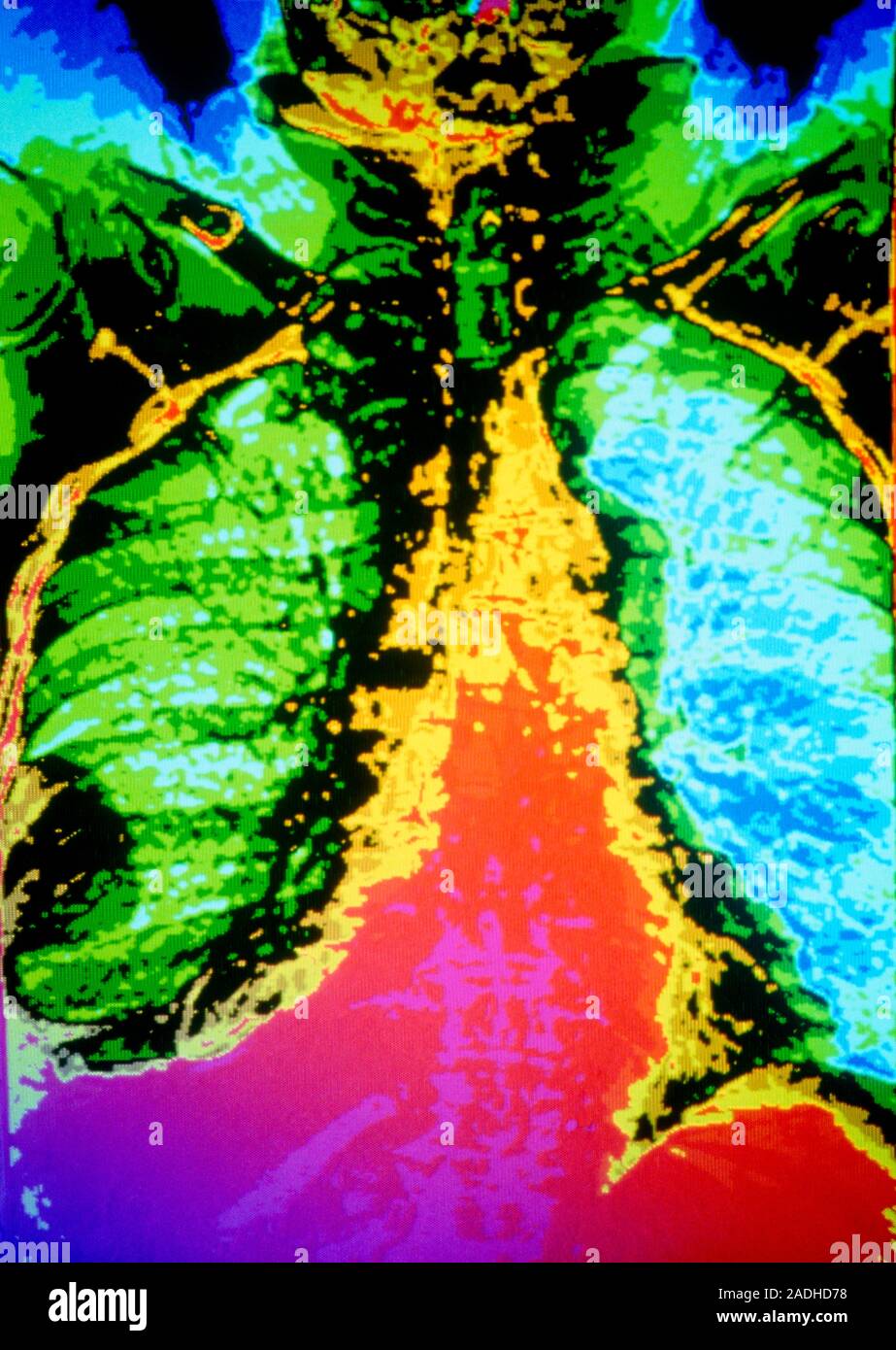 Cancer of lung. Coloured computed tomography (CT) scan showing the ... Cancer of lung. Coloured computed tomography (CT) scan showing the ...