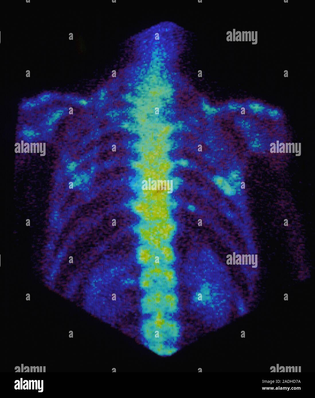 Bone metastases. Coloured gamma camera scan (scintigram) of the spine and ribs of a female ...