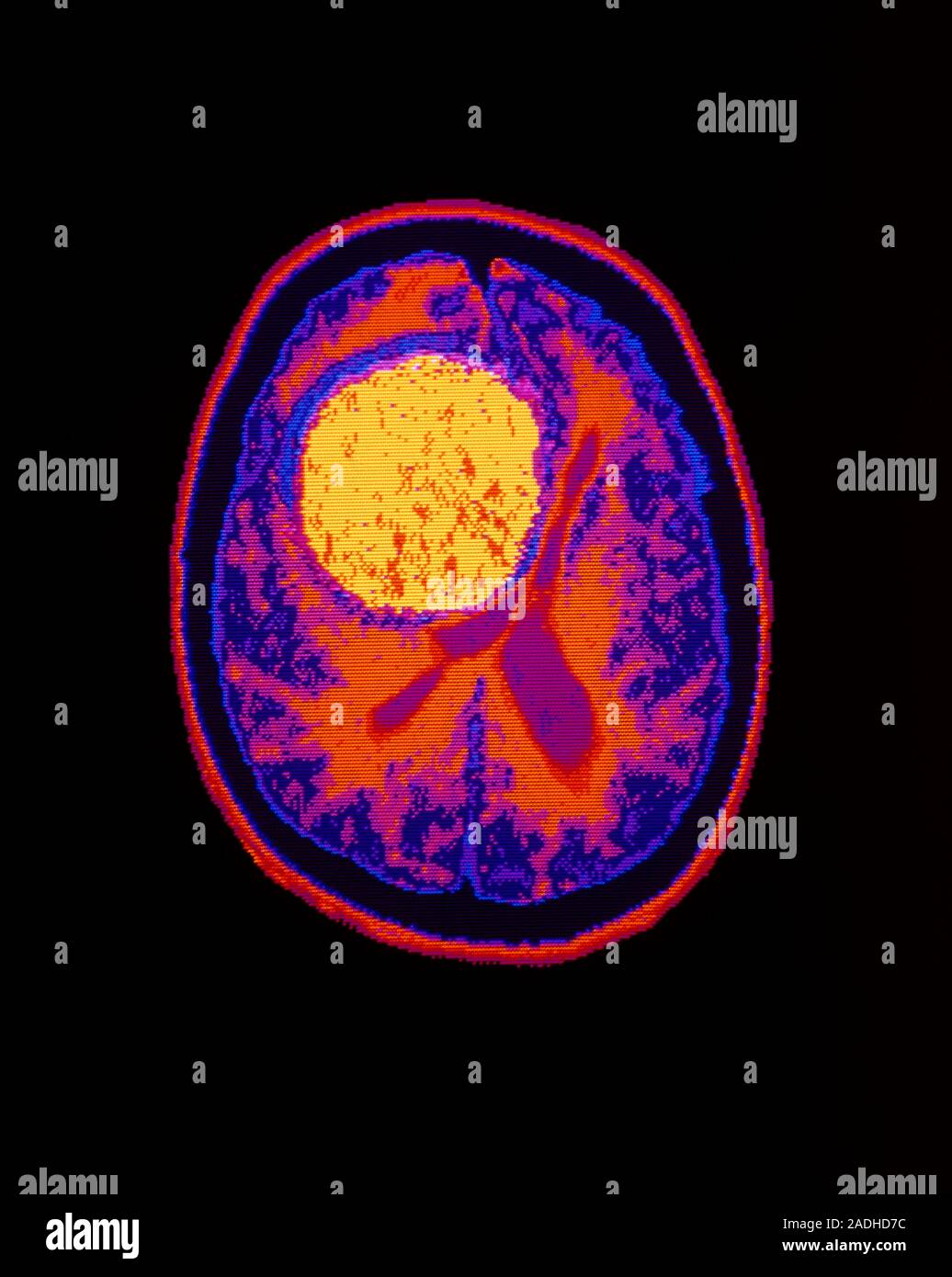 Coloured computed tomography (CT) brain scan showing a large, intracranial tumour, the large ...
