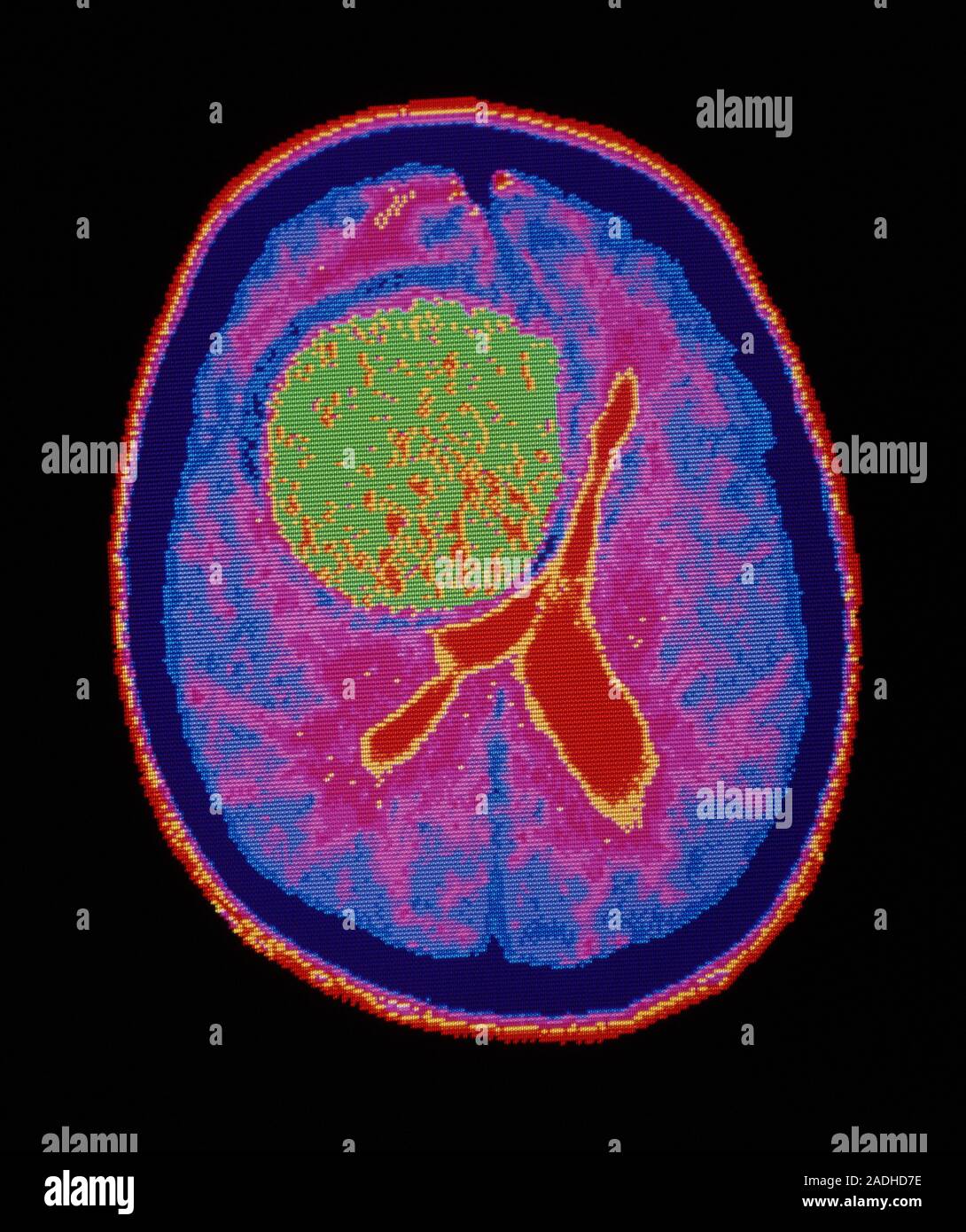 Coloured computed tomography (CT) brain scan showing a large, intracranial tumour, the large ...
