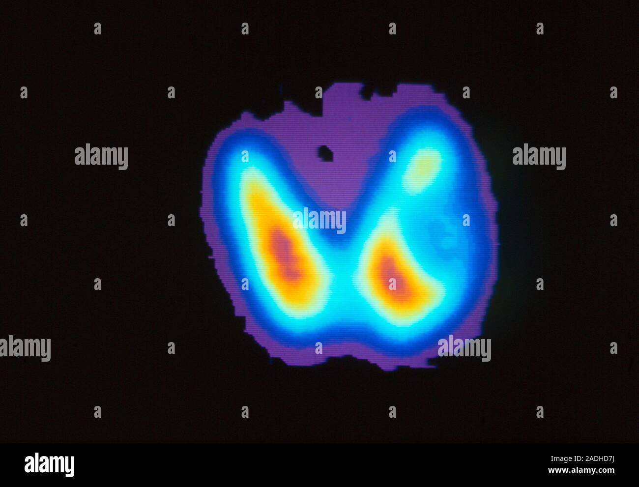 Thyroid cancer. Coloured Gamma Camera scan (scintigram) of the human ...