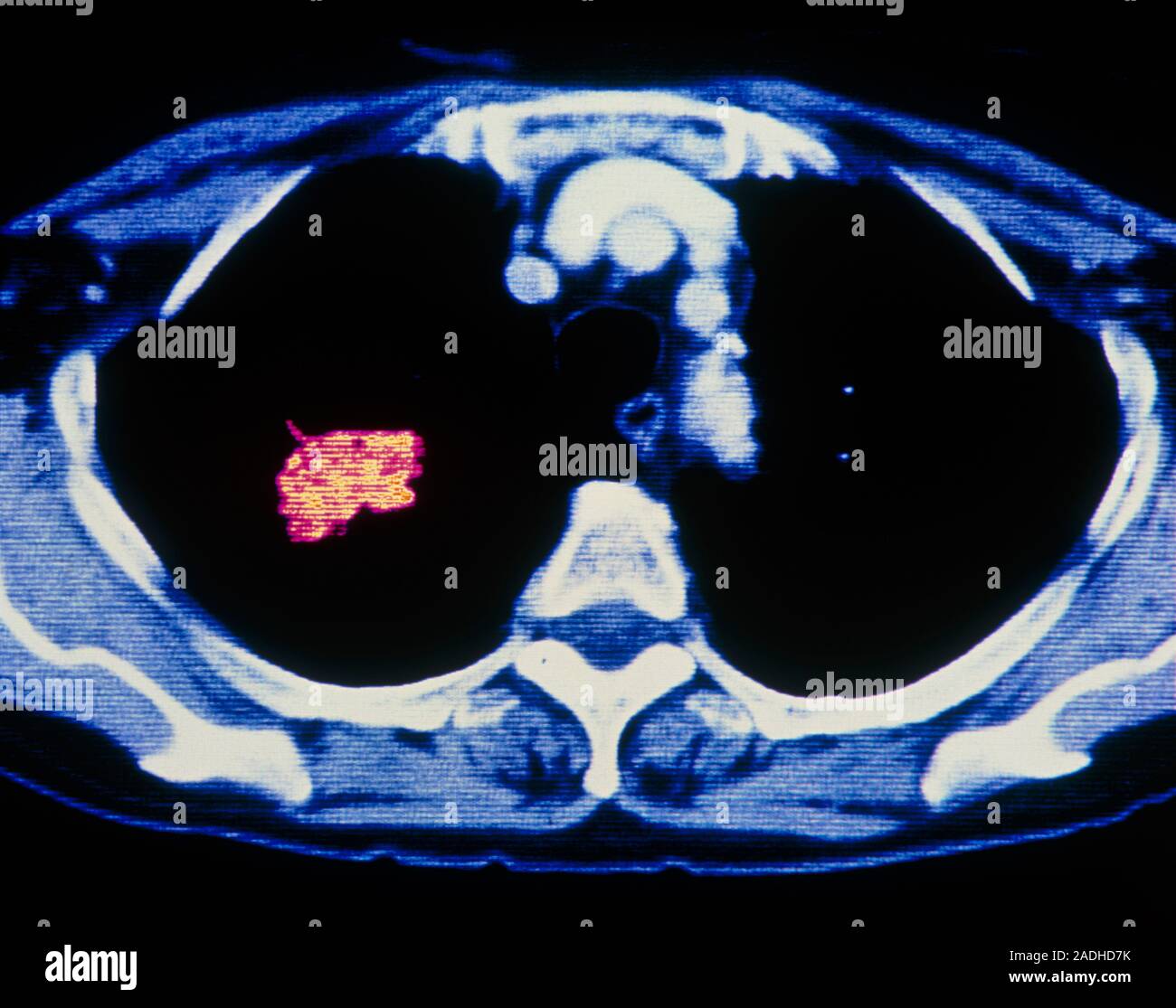 Lung cancer. Coloured Computed Tomography (CT) scan of an axial section ... Lung cancer. Coloured Computed Tomography (CT) scan of an axial section ...
