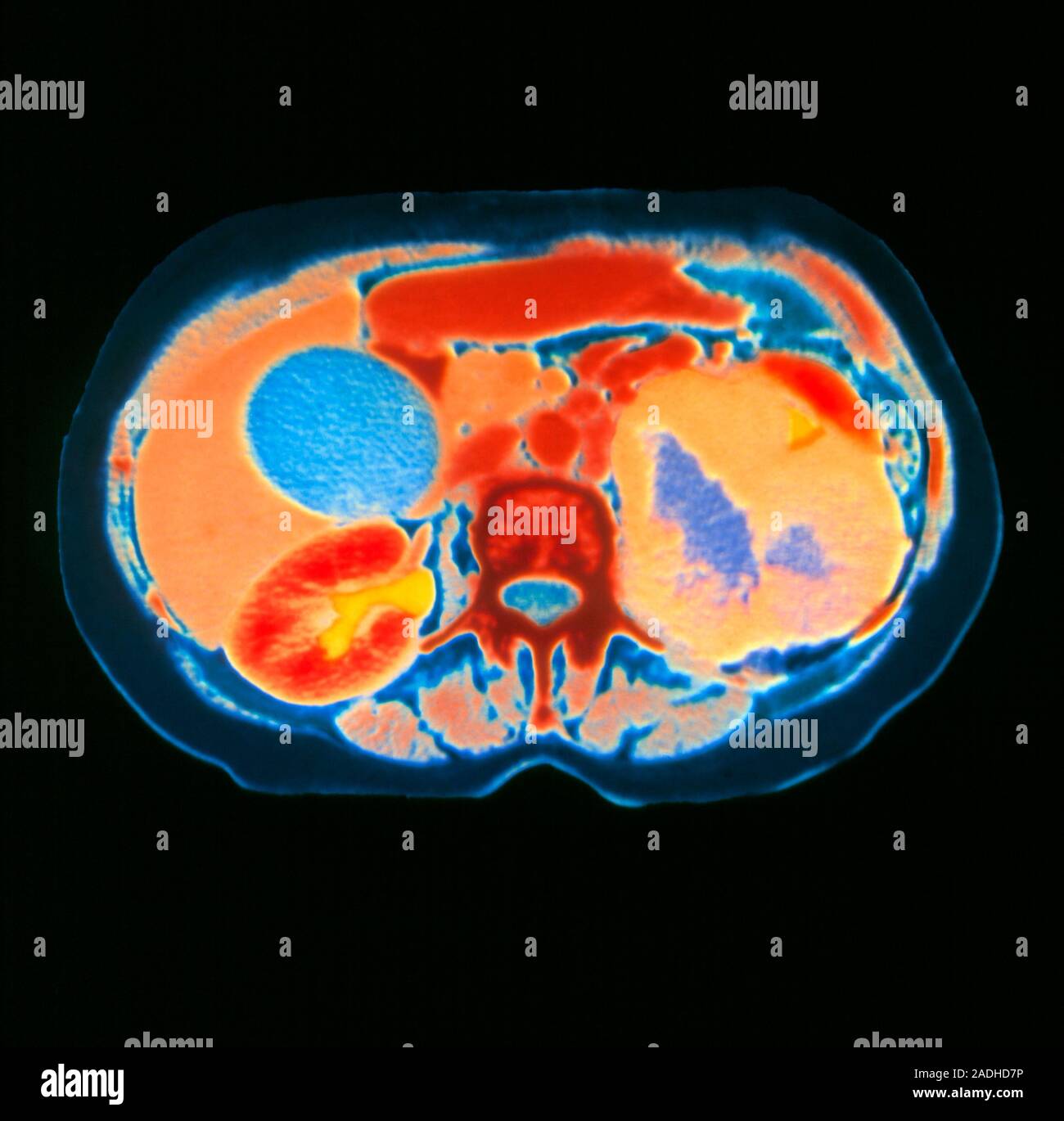Kidney cancer. Coloured computed Tomography (CT) scan, axial section, of the human abdomen ...
